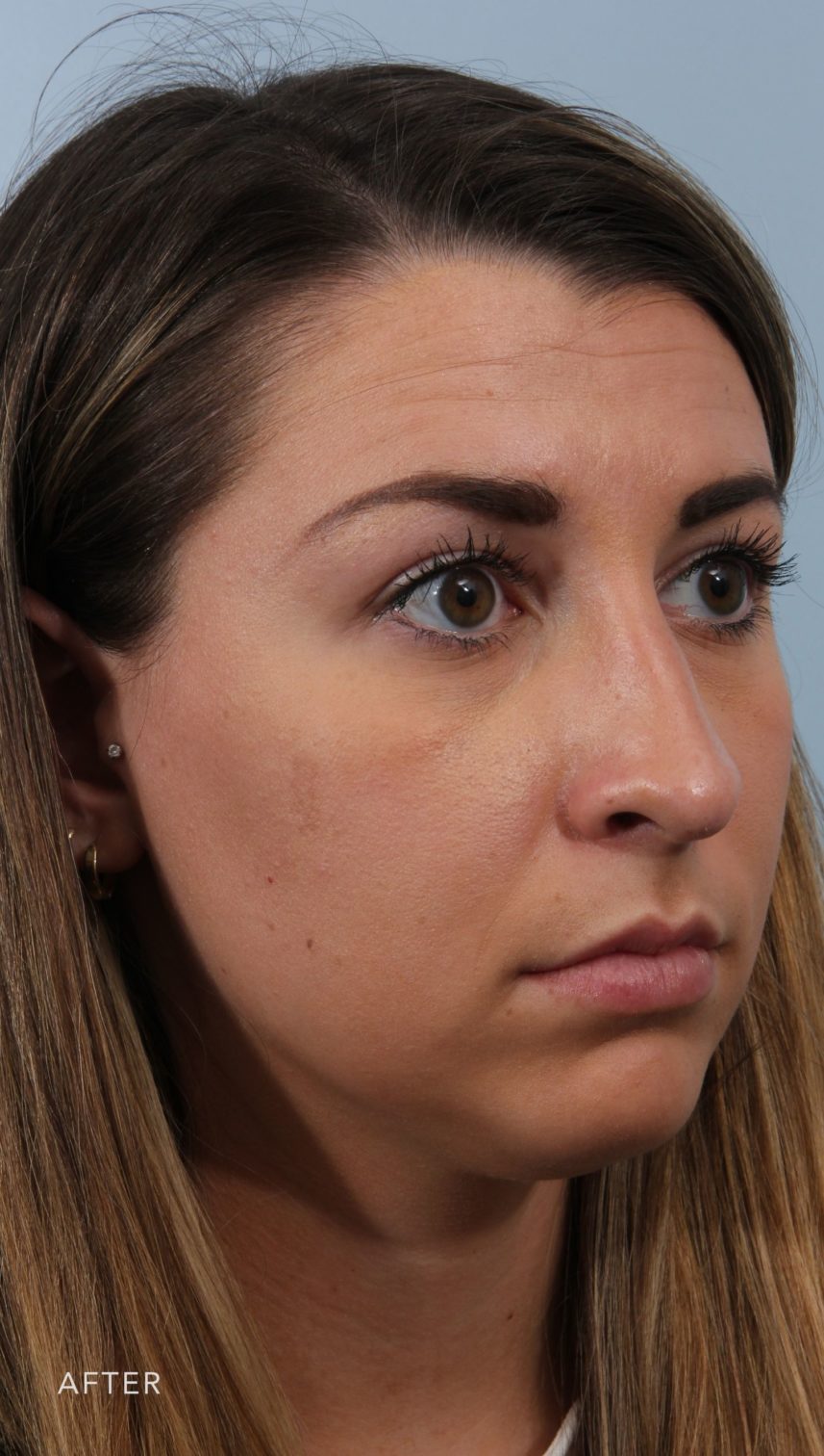 Rhinoplasty & Nasal Reconstruction Pictures | Williams Center Williams ...