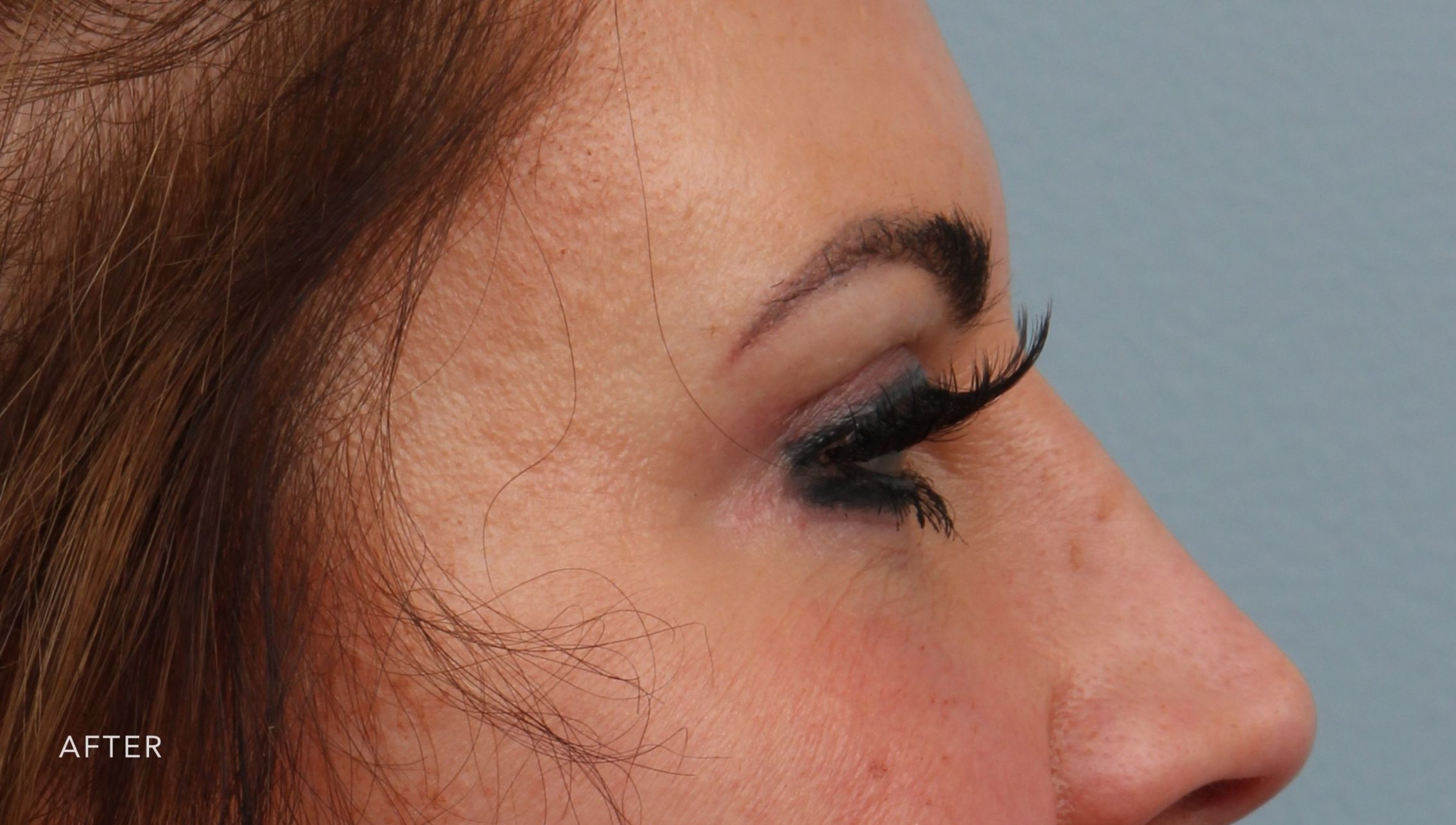 Blepharoplasty Pictures - Eyelid Surgery | Williams Center Williams Center