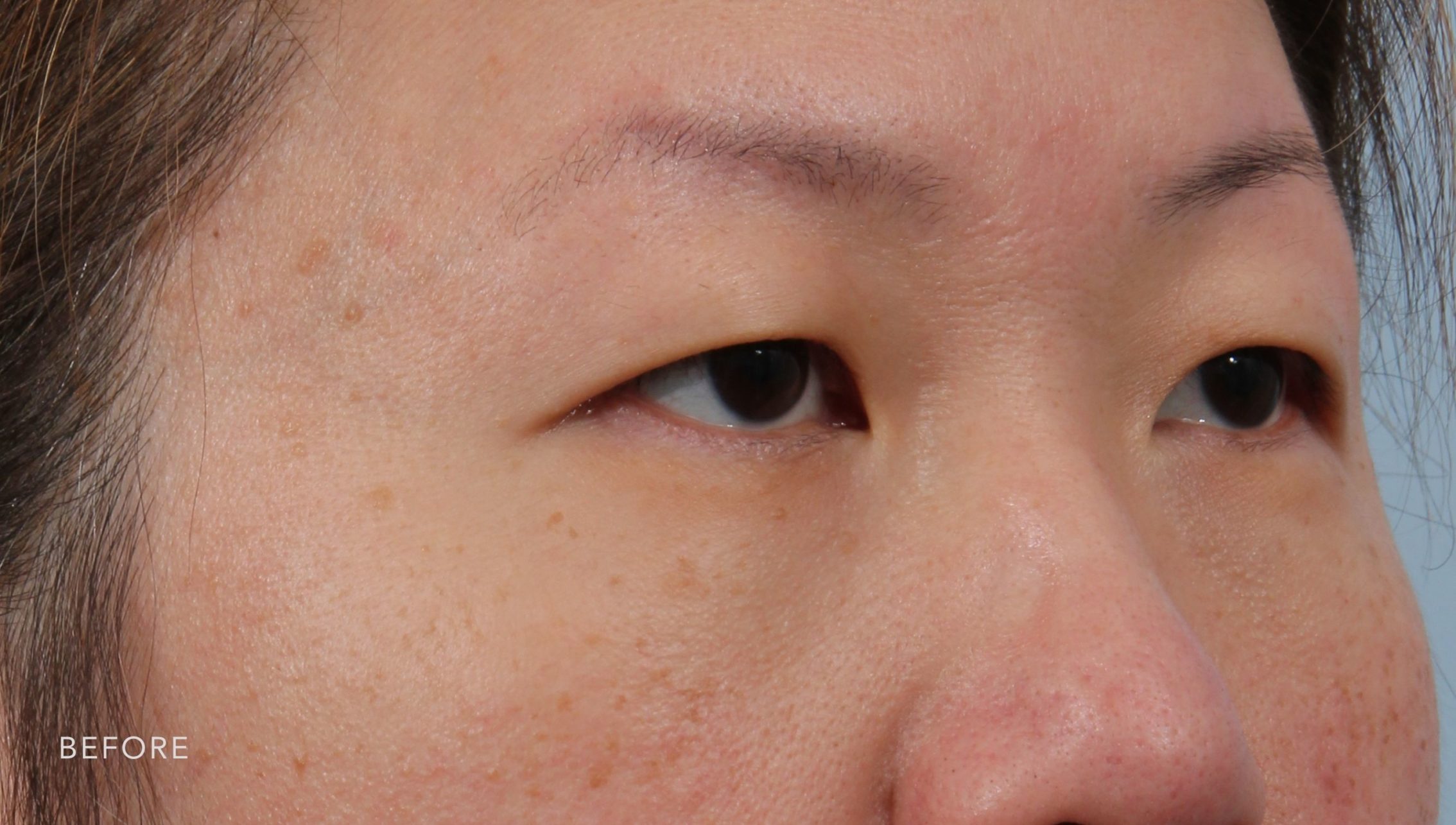 Blepharoplasty Pictures - Eyelid Surgery | Williams Center Williams Center