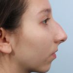 Rhinoplasty & Nasal Reconstruction Pictures | Williams Center Williams ...