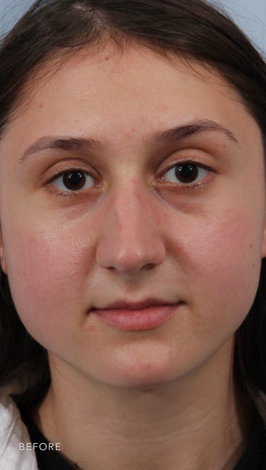 Rhinoplasty & Nasal Reconstruction Pictures | Williams Center Williams ...