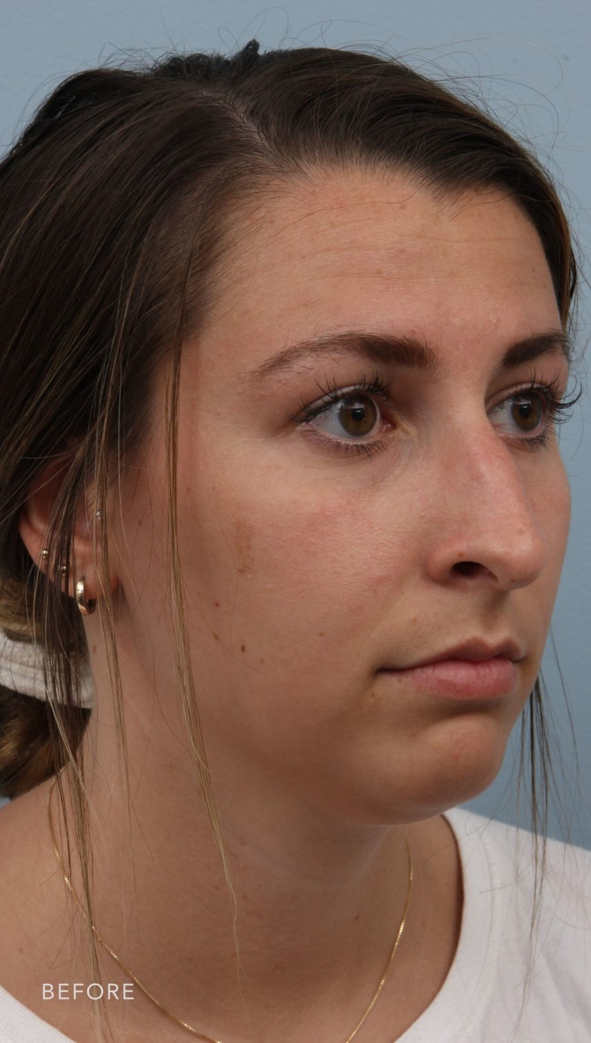 Rhinoplasty & Nasal Reconstruction Pictures | Williams Center Williams ...