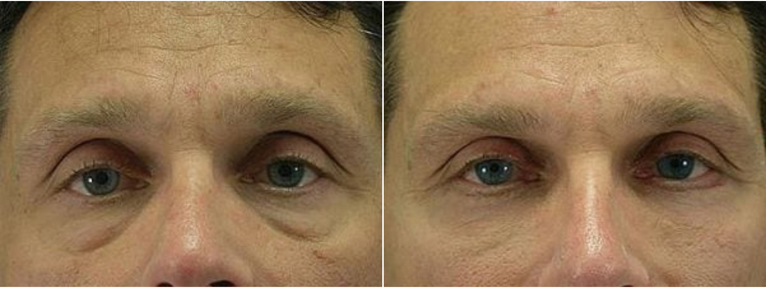 Eyelid Plastic Surgery - Blepharoplasty | Williams Center Williams Center
