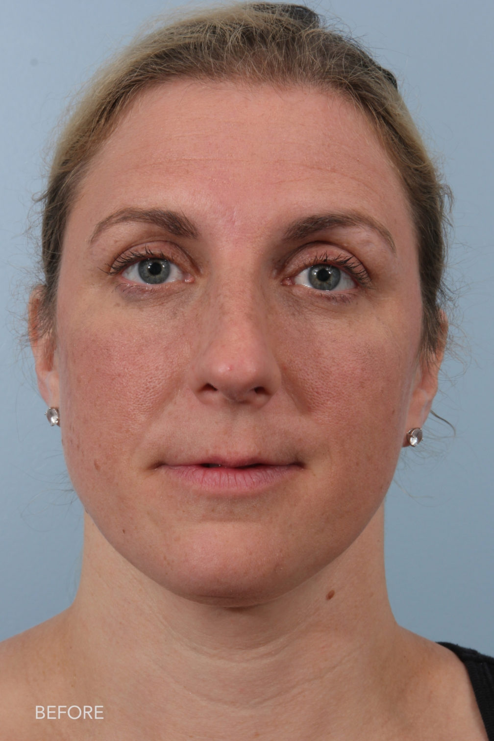 Rhinoplasty & Nasal Reconstruction Pictures | Williams Center Williams ...