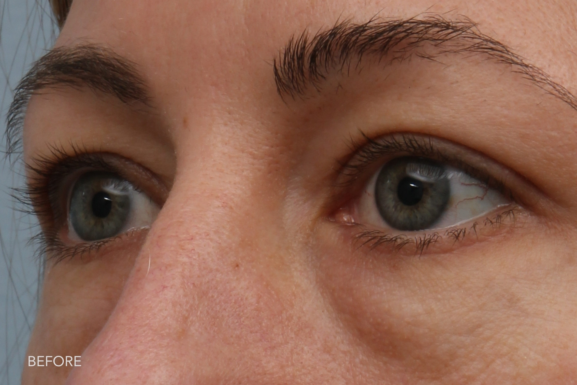 Blepharoplasty Pictures - Eyelid Surgery | Williams Center Williams Center