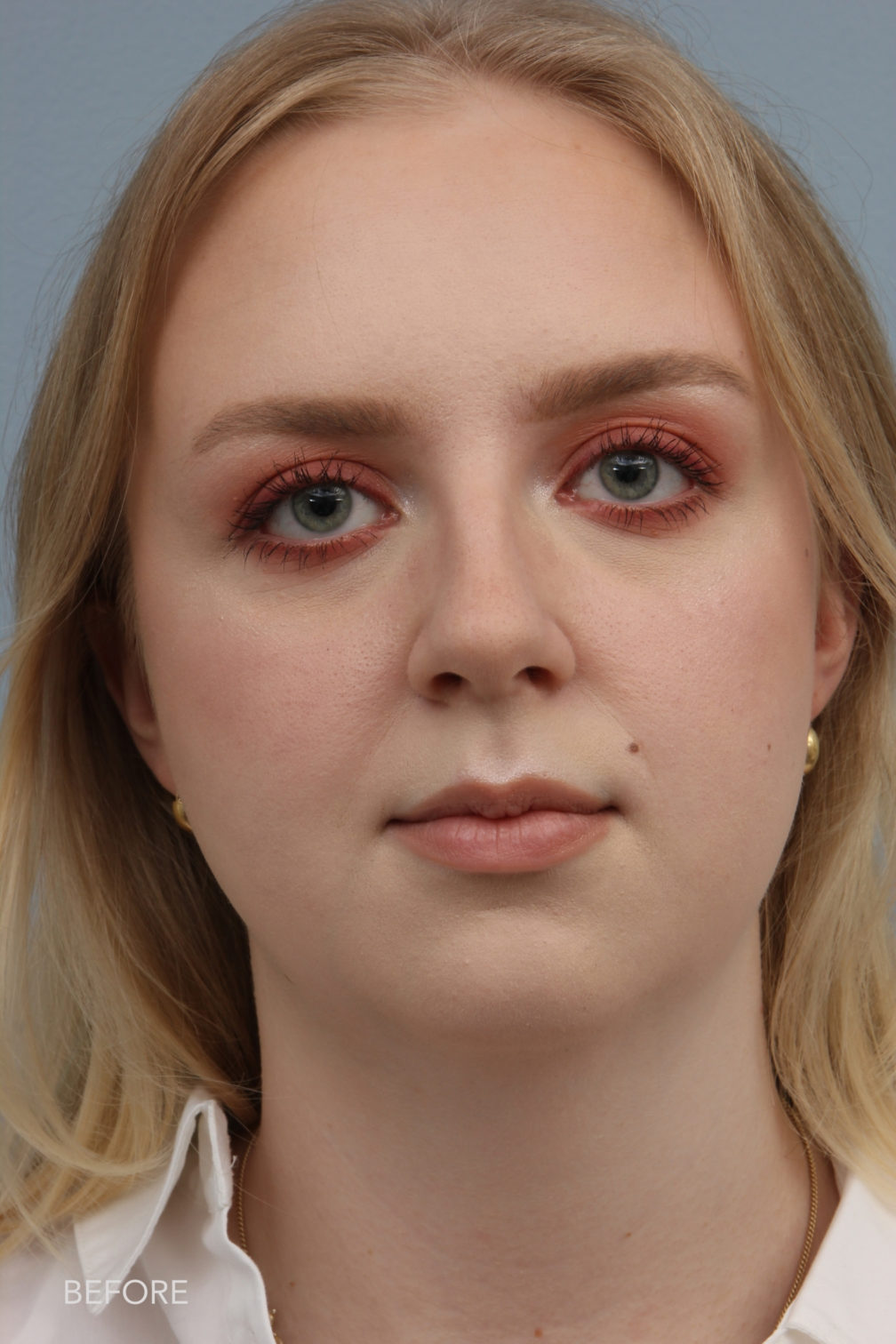 Chin Augmentation Gallery | Williams Center Williams Center