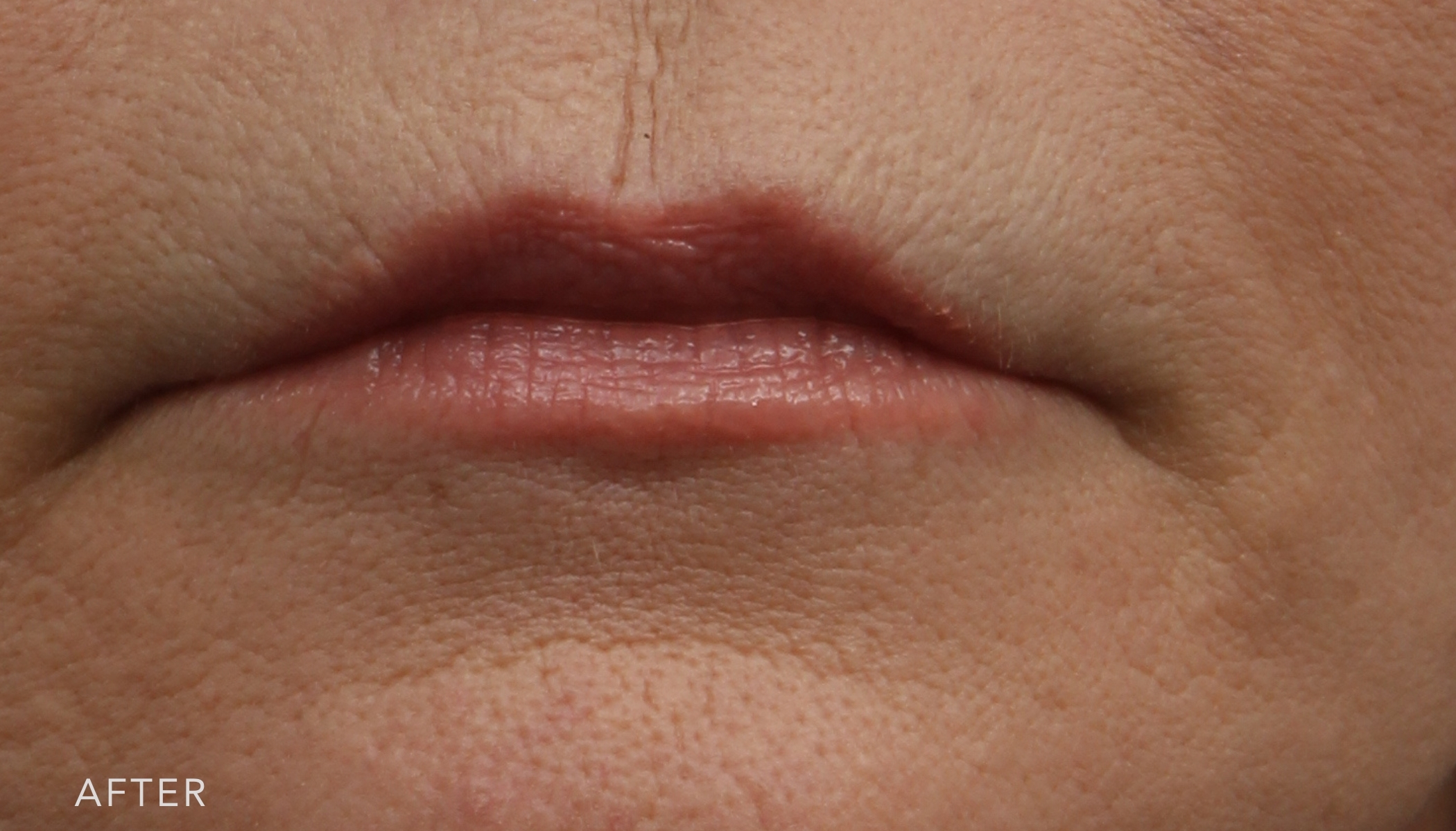 Lip Lift Before & After Gallery - The Williams Center Williams Center