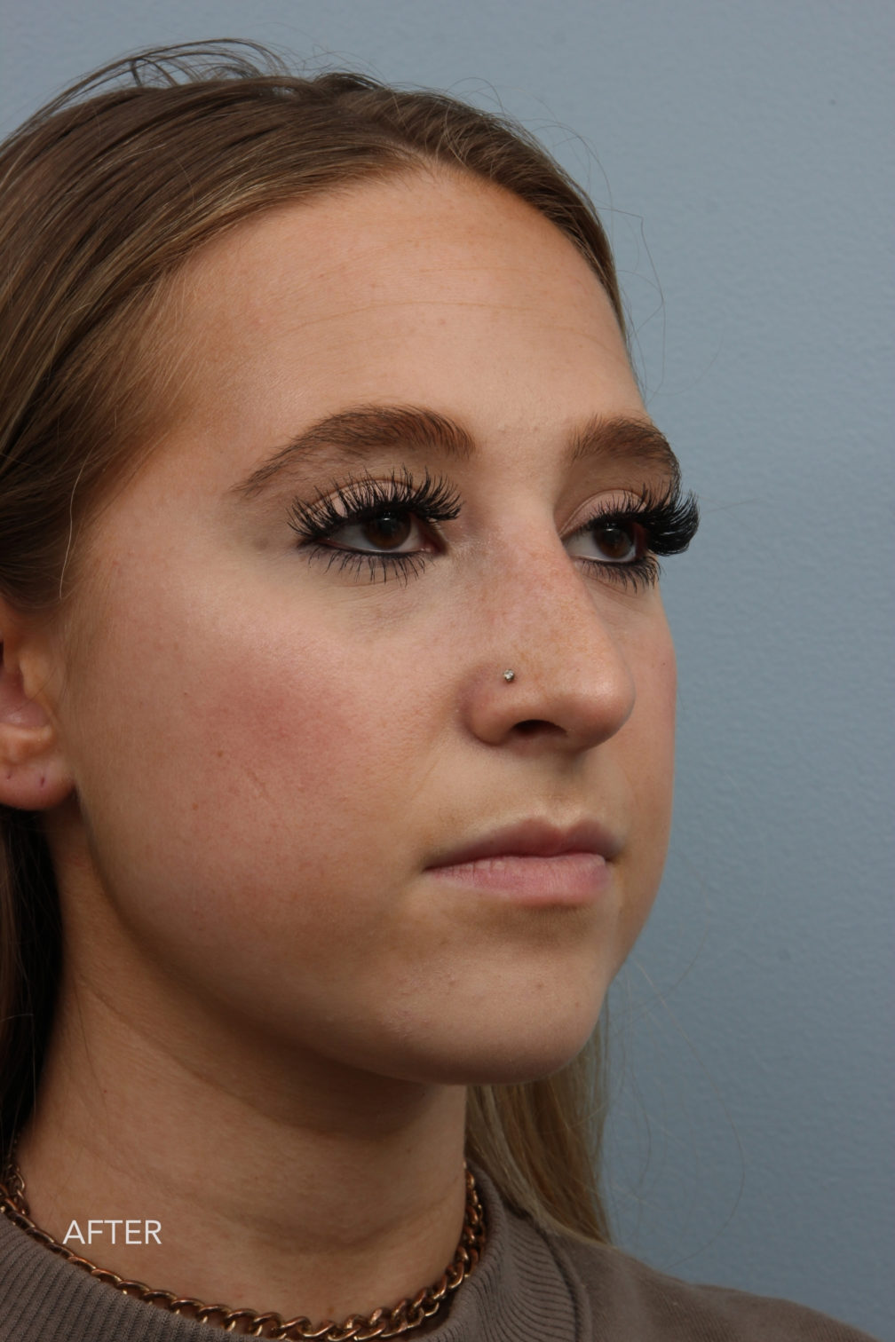 Rhinoplasty & Nasal Reconstruction Gallery | The Williams Center ...