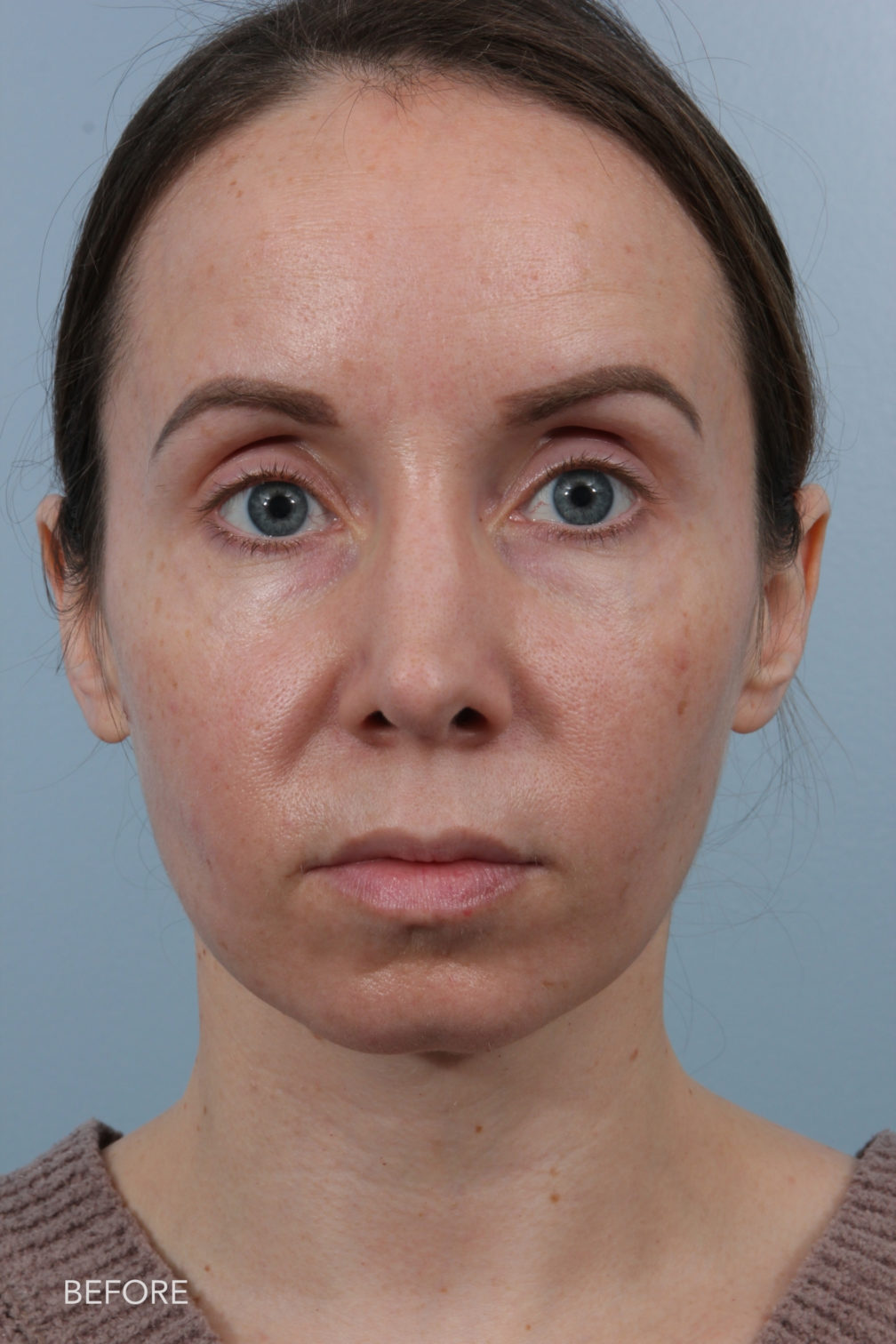 Rhinoplasty & Nasal Reconstruction Pictures | Williams Center Williams ...