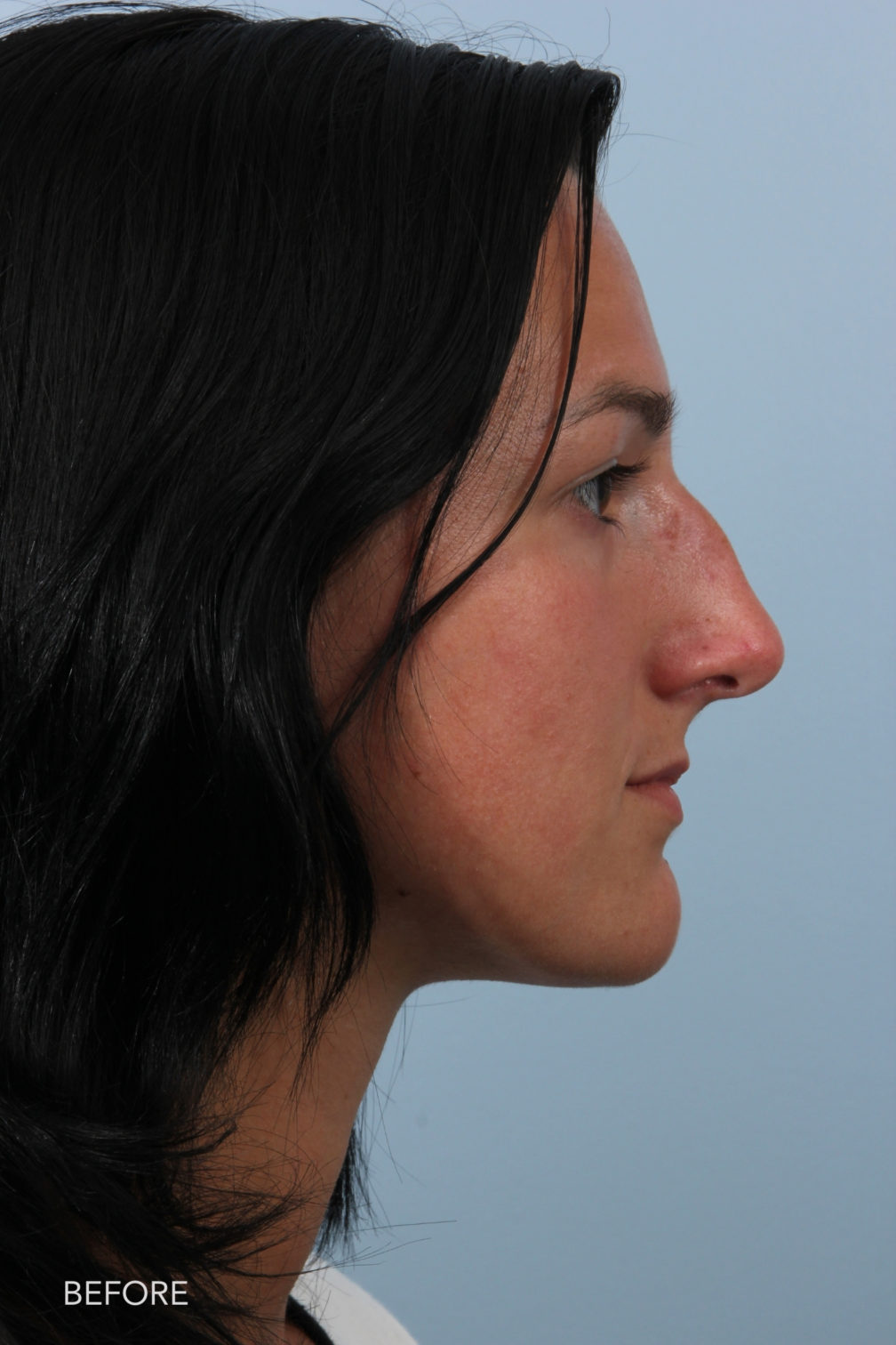 Rhinoplasty & Nasal Reconstruction Pictures | Williams Center Williams ...