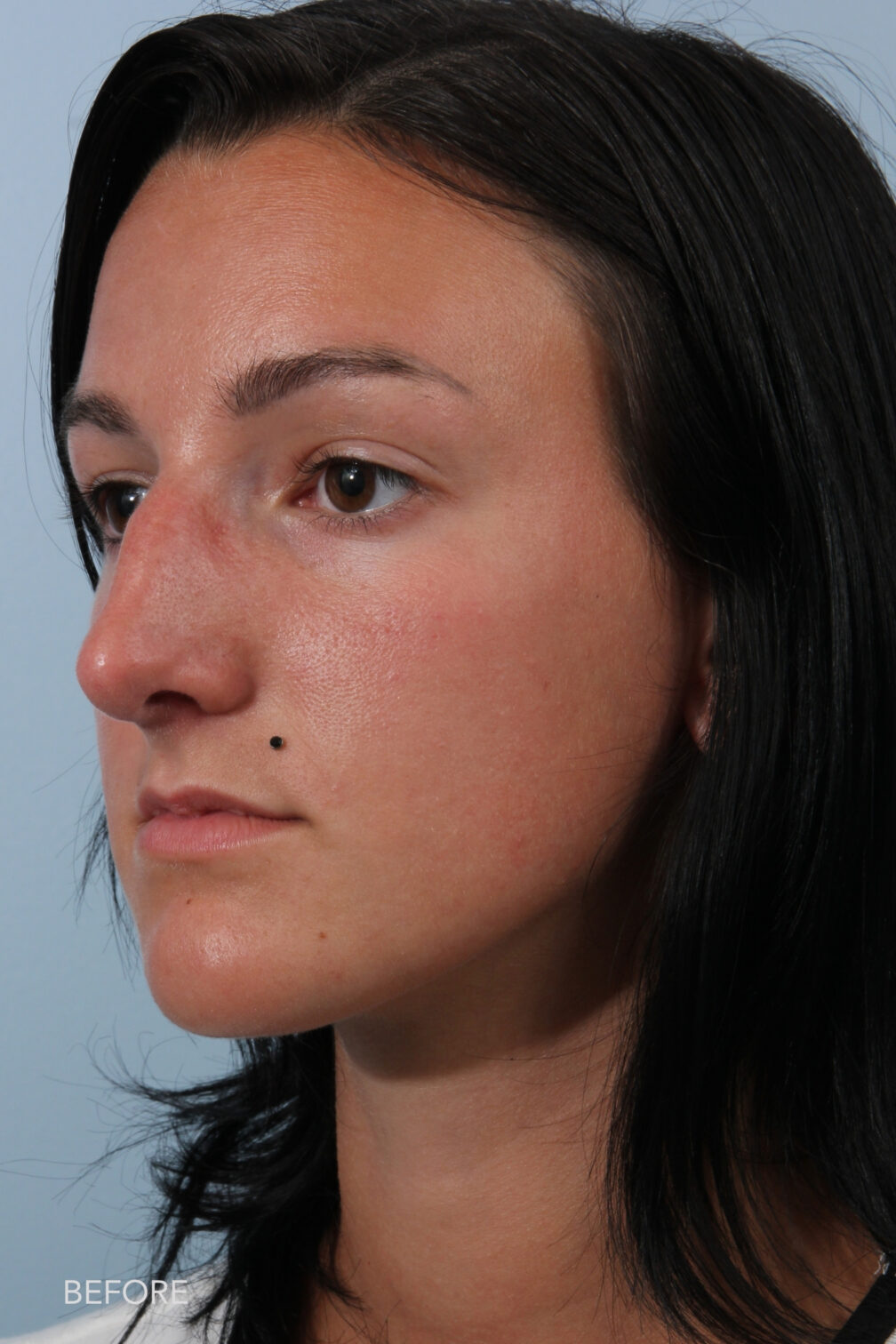 Rhinoplasty & Nasal Reconstruction Pictures | Williams Center Williams ...