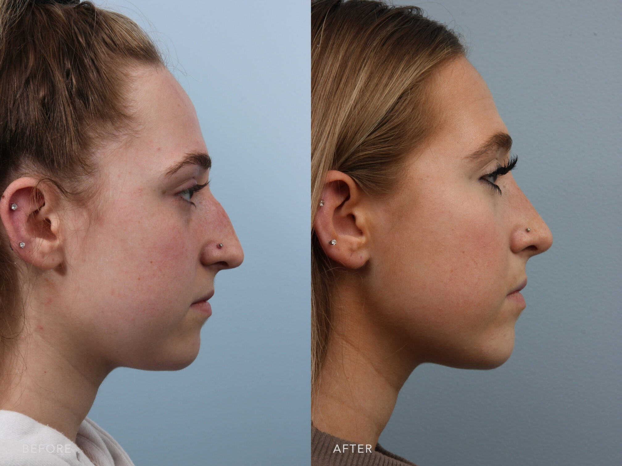 How Much Does Rhinoplasty Surgery Cost? | Williams Center Williams Center