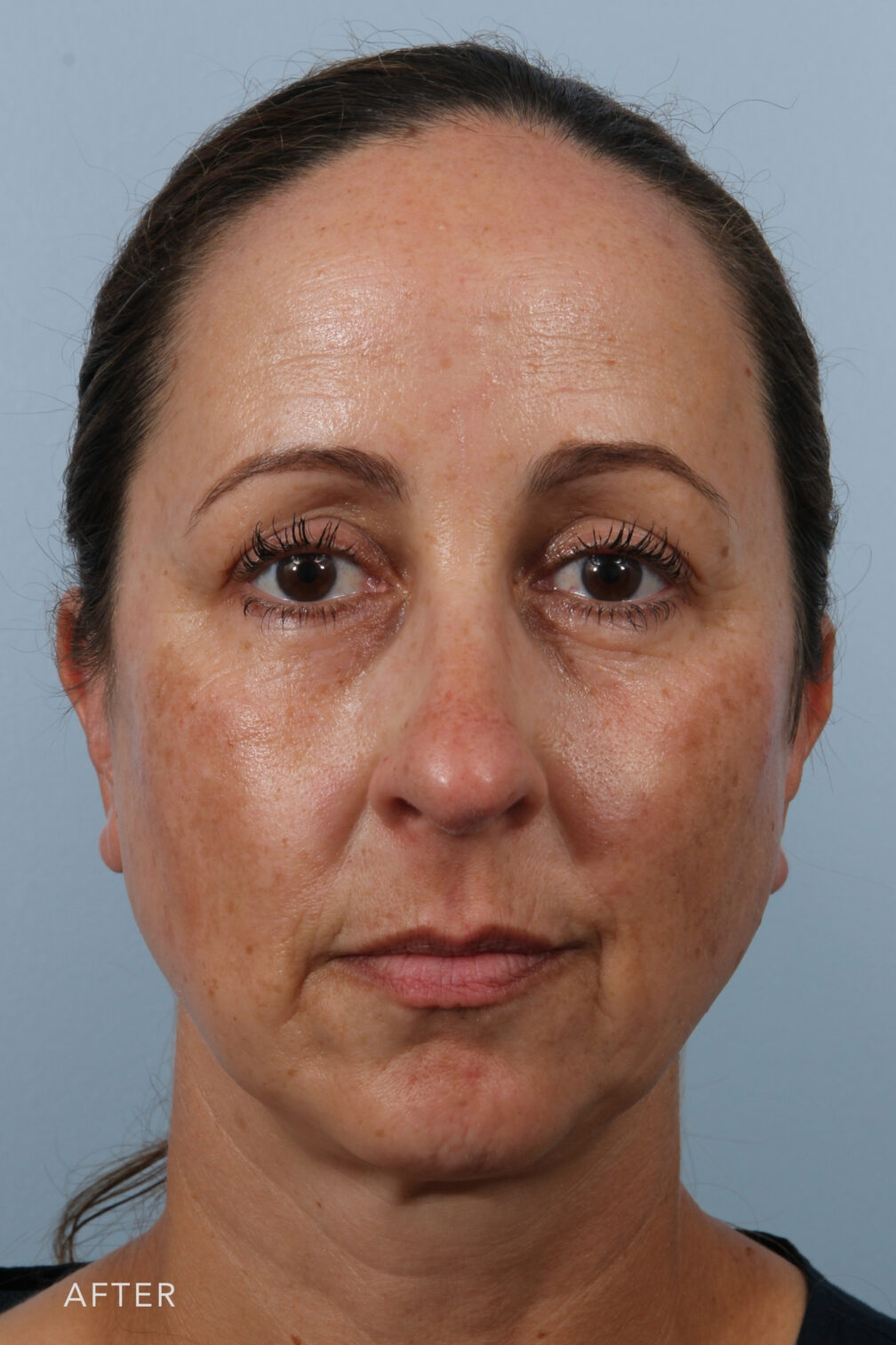 Rhinoplasty & Nasal Reconstruction Pictures | Williams Center Williams ...