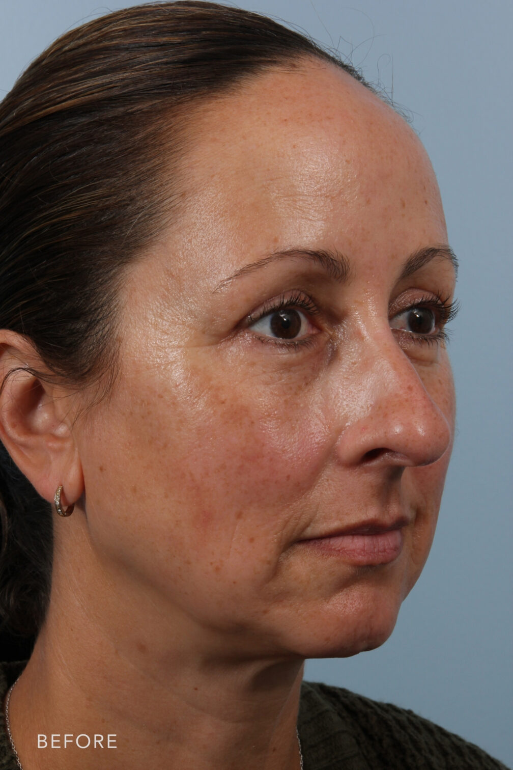 Rhinoplasty & Nasal Reconstruction Pictures | Williams Center Williams ...