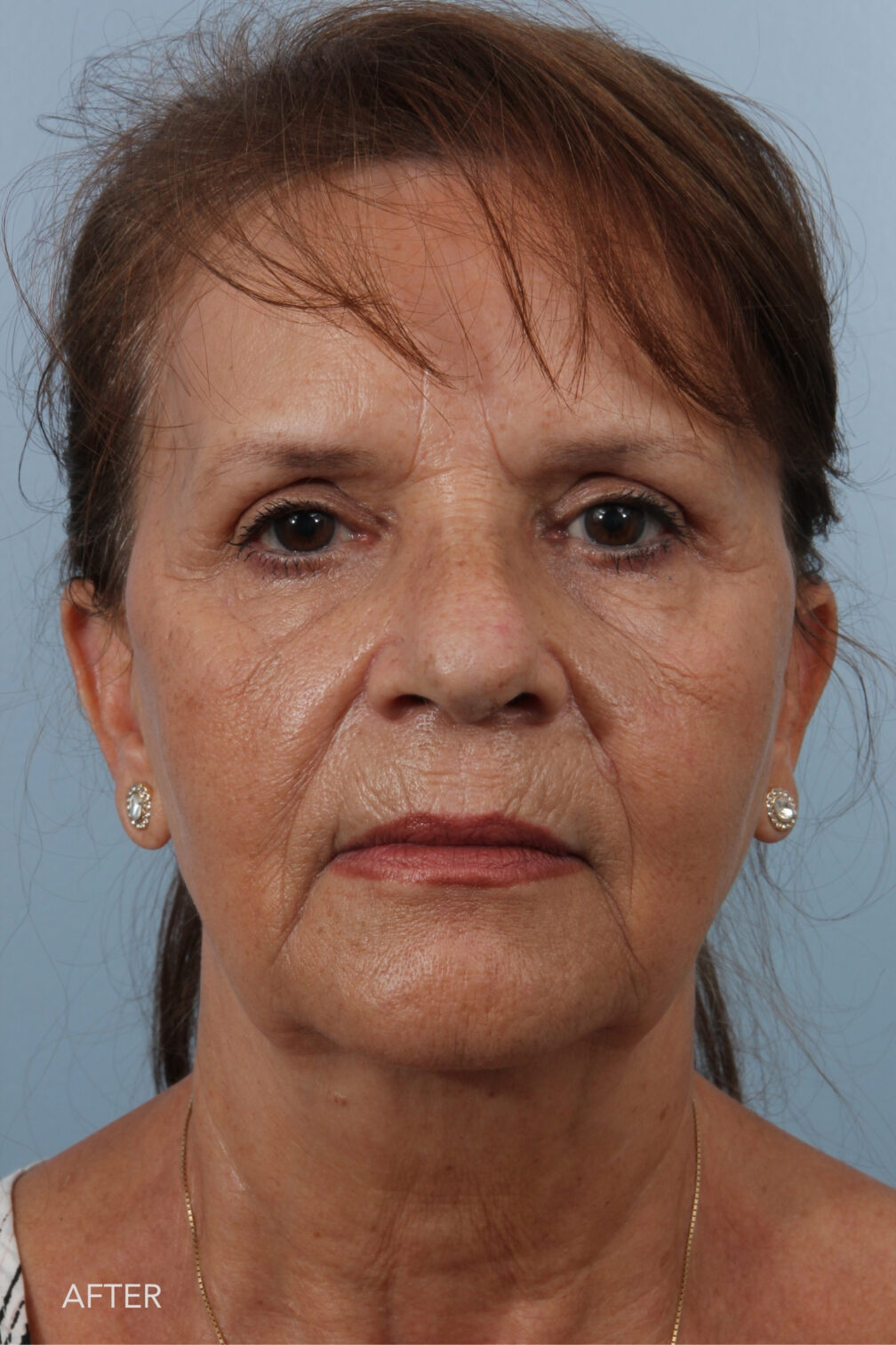 Blepharoplasty Pictures - Eyelid Surgery | Williams Center Williams Center