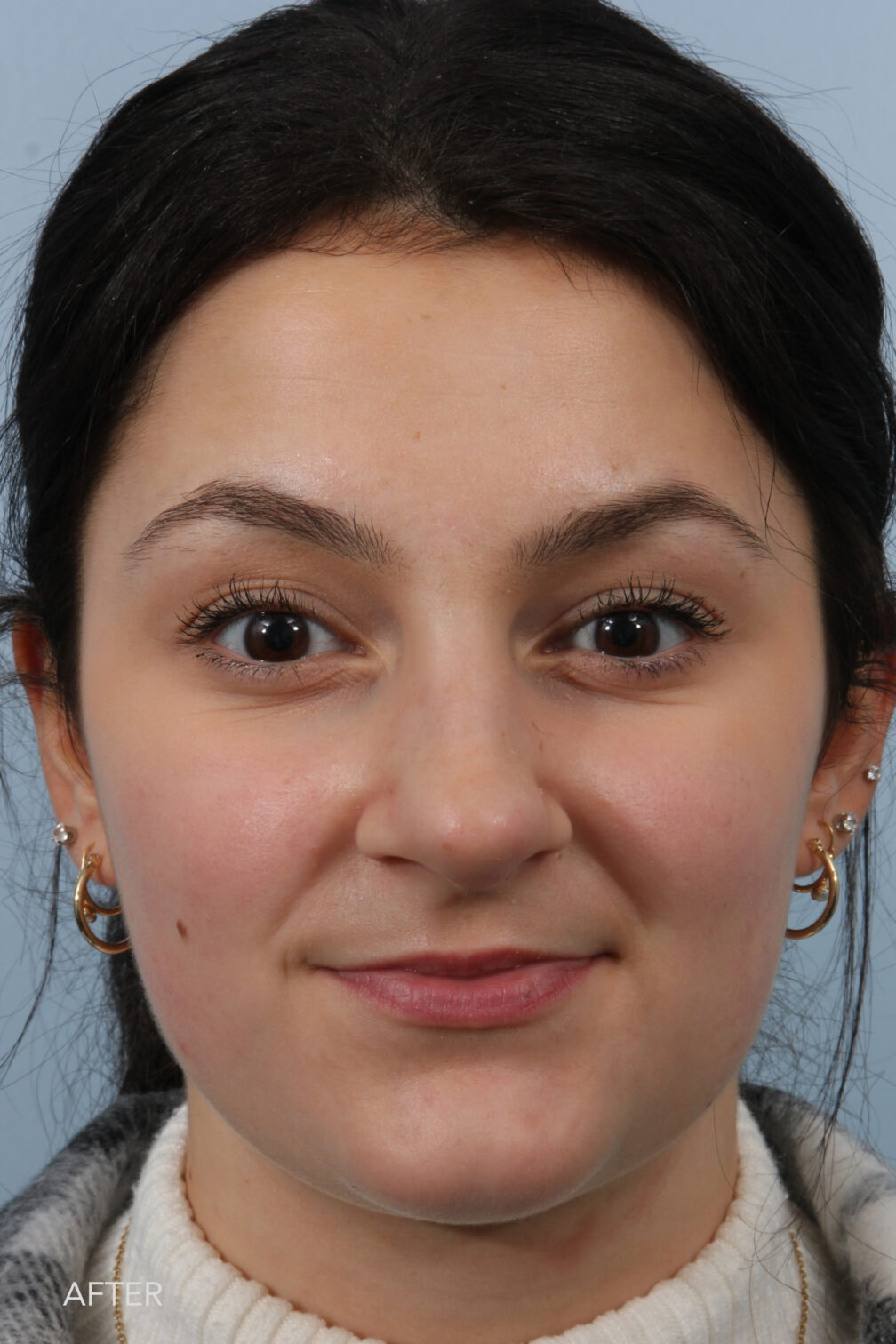 Rhinoplasty & Nasal Reconstruction Pictures | Williams Center Williams ...