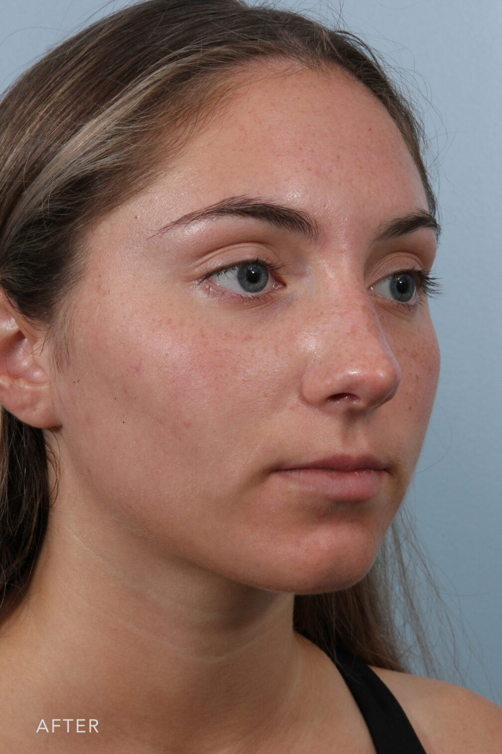 Rhinoplasty & Nasal Reconstruction Pictures | Williams Center Williams ...