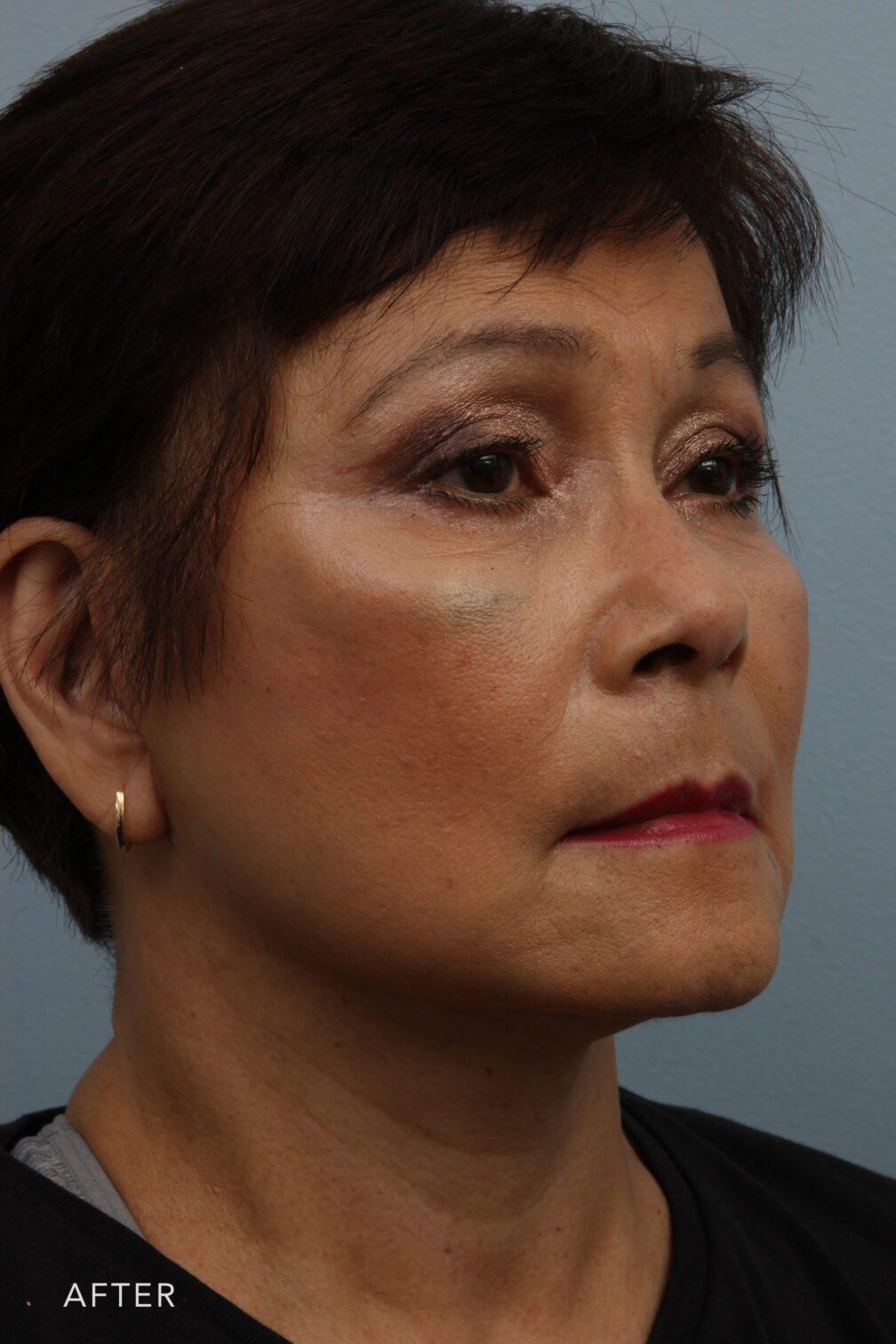 Blepharoplasty Pictures - Eyelid Surgery | Williams Center Williams Center