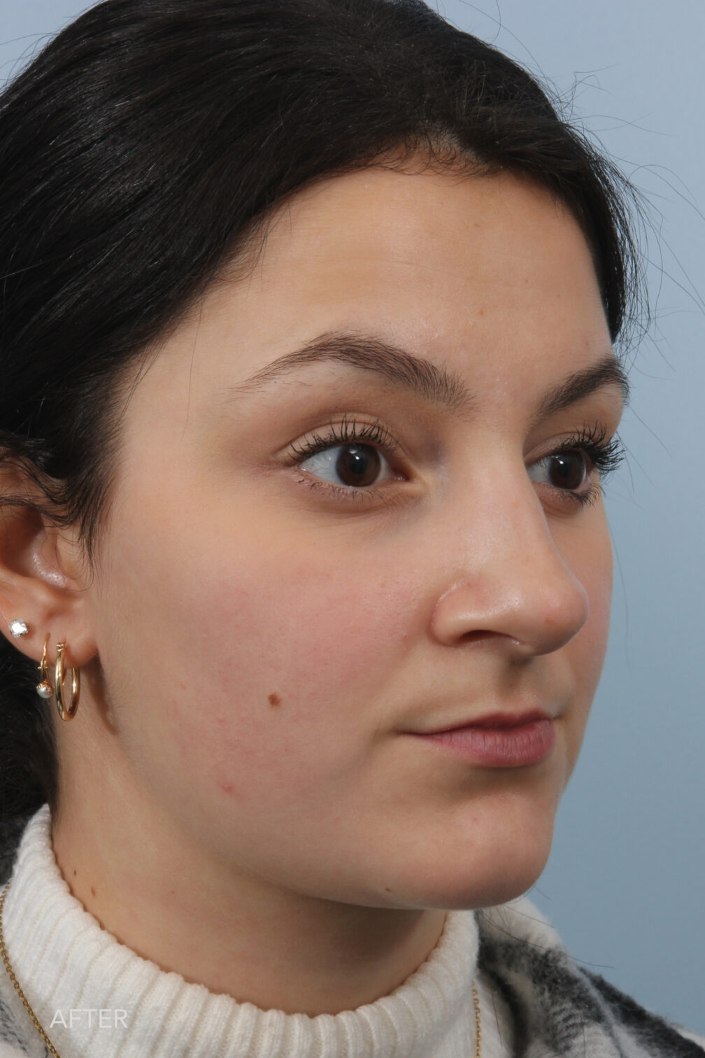 Rhinoplasty & Nasal Reconstruction Gallery | The Williams Center ...