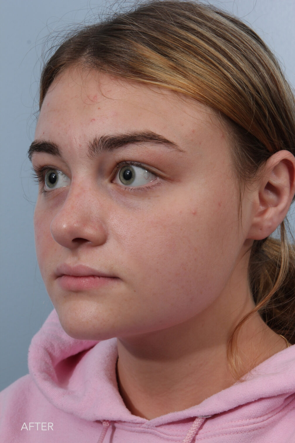 Rhinoplasty & Nasal Reconstruction Pictures | Williams Center Williams ...