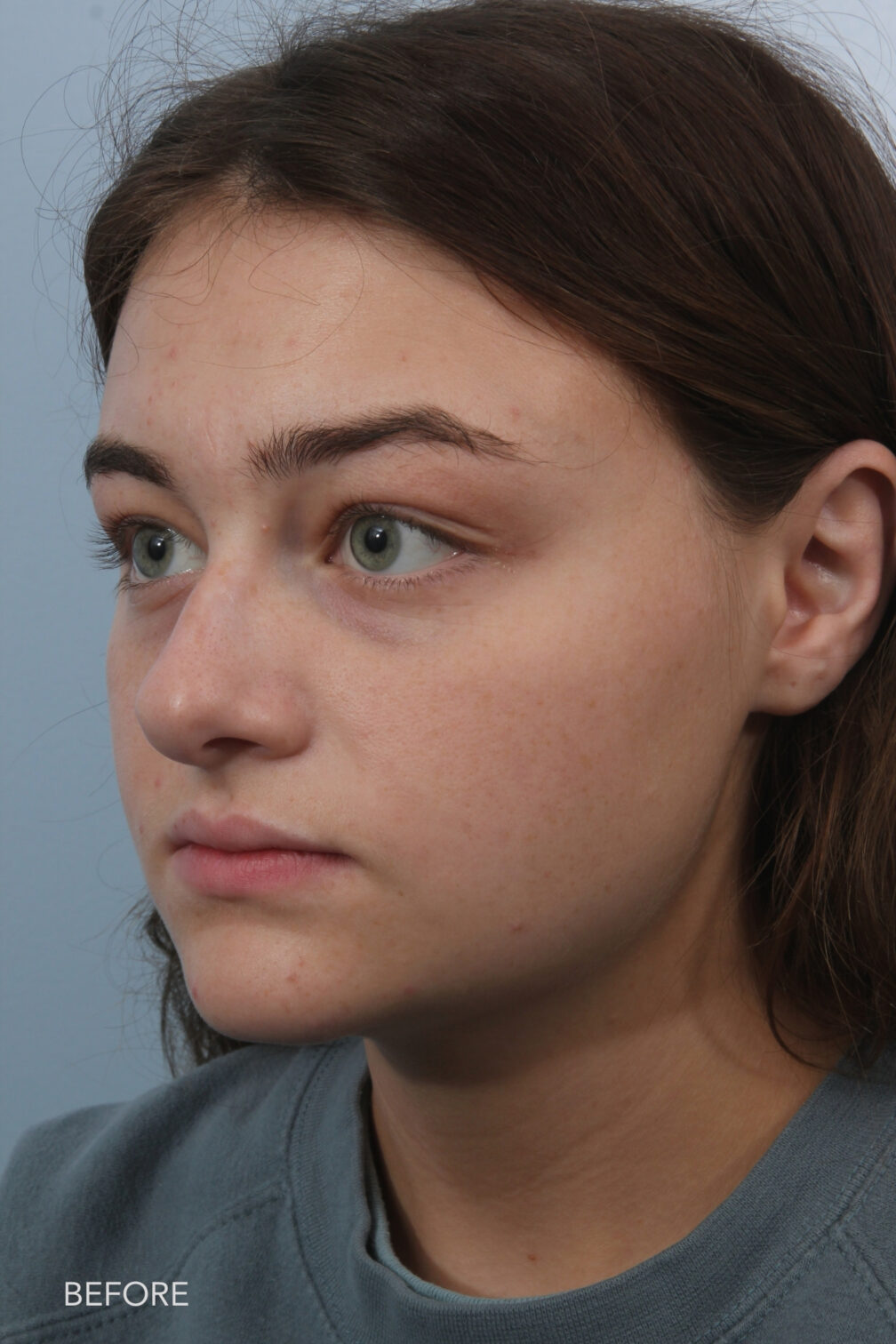 Rhinoplasty & Nasal Reconstruction Pictures | Williams Center Williams ...