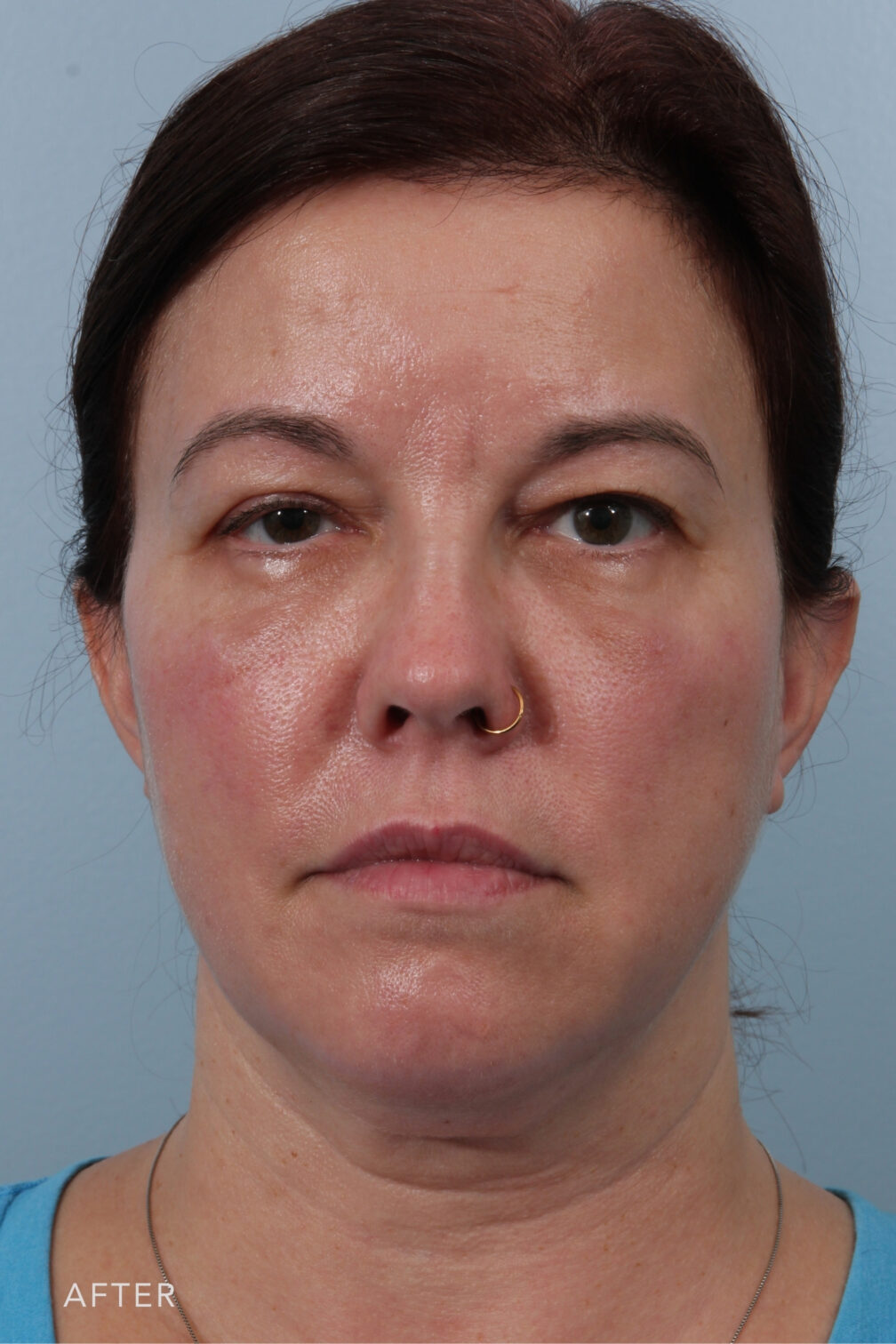 Blepharoplasty Pictures - Eyelid Surgery | Williams Center Williams Center