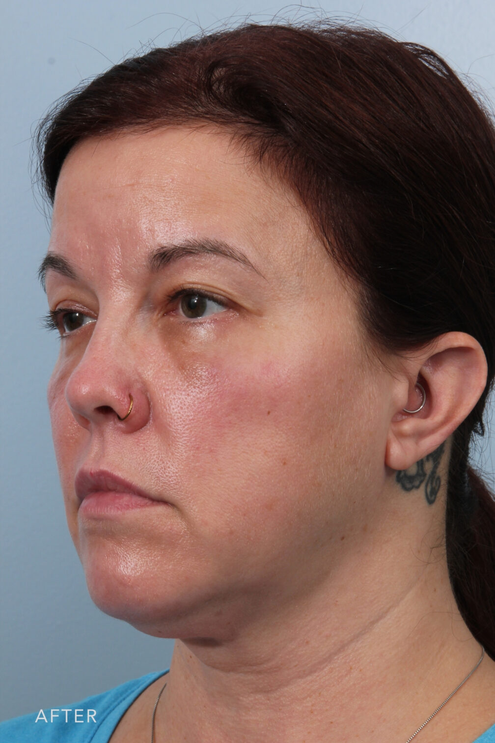Blepharoplasty Pictures - Eyelid Surgery | Williams Center Williams Center