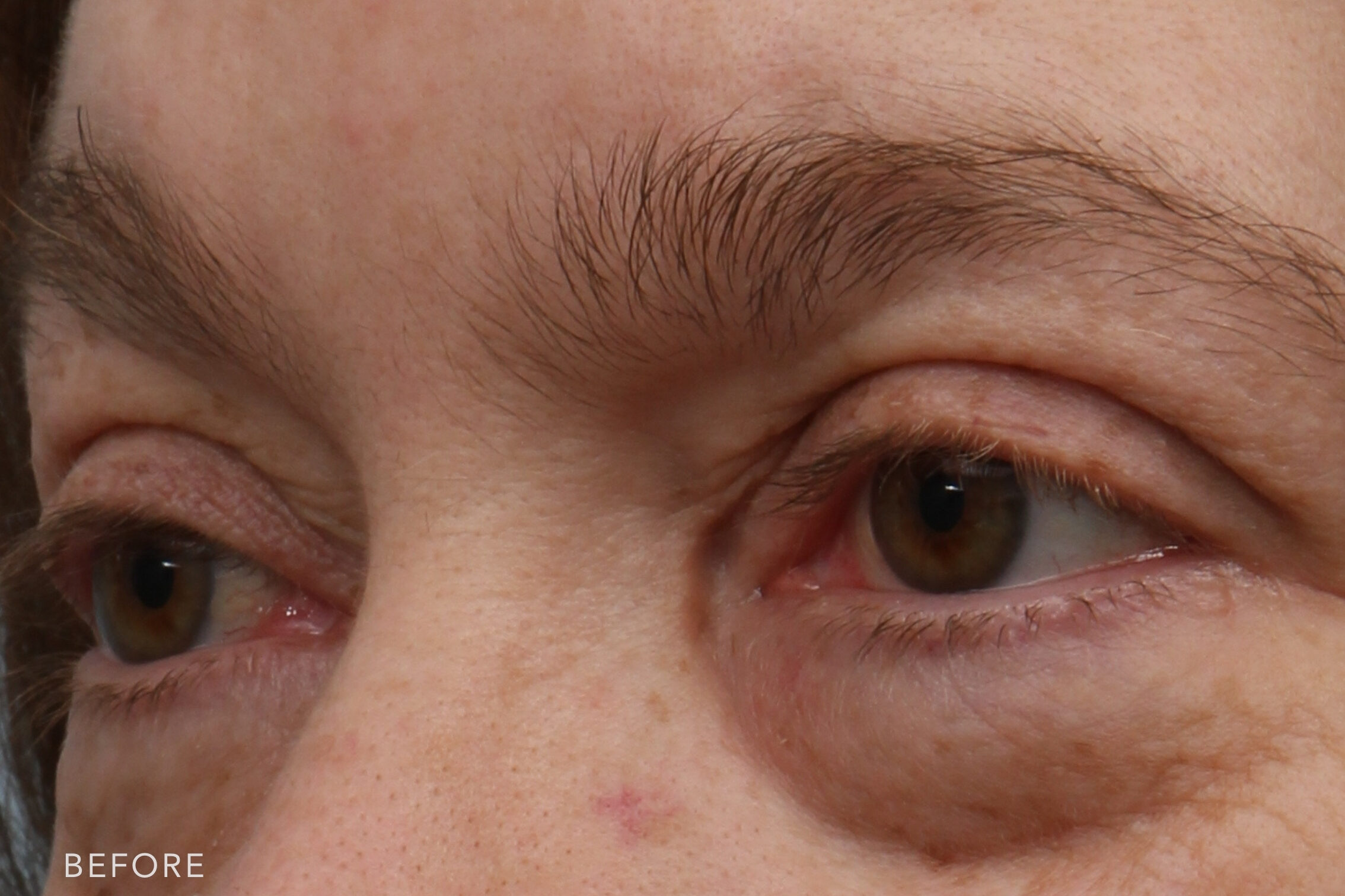 Blepharoplasty Pictures - Eyelid Surgery | Williams Center Williams Center