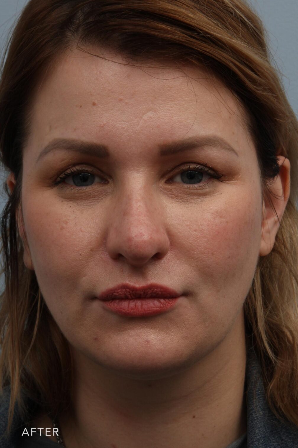 Rhinoplasty & Nasal Reconstruction Pictures | Williams Center Williams ...