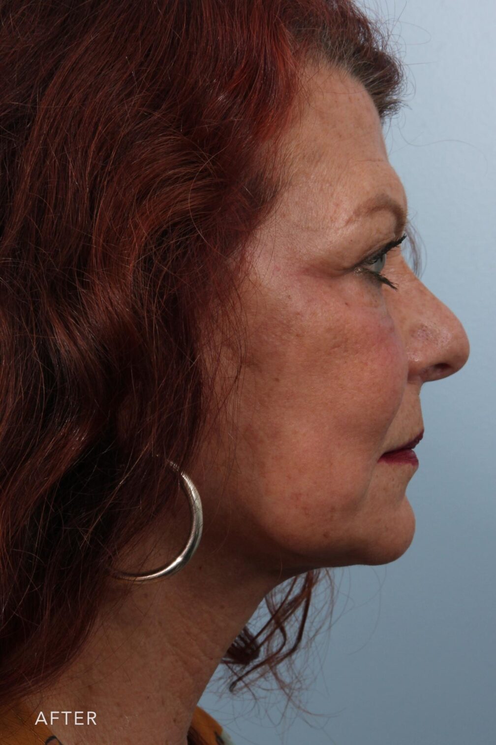 Deep Plane Facelift Before & After Pictures | Williams Center Williams ...