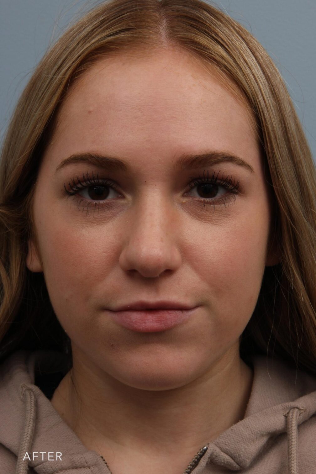 Rhinoplasty & Nasal Reconstruction Pictures | Williams Center Williams ...