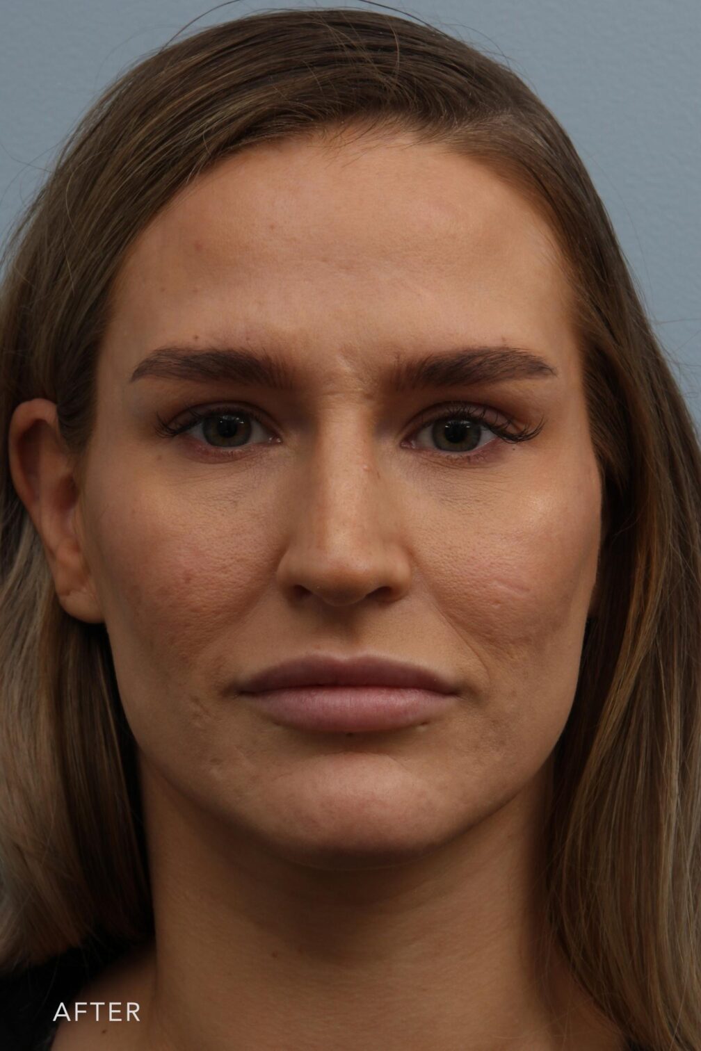 Rhinoplasty & Nasal Reconstruction Pictures | Williams Center Williams ...