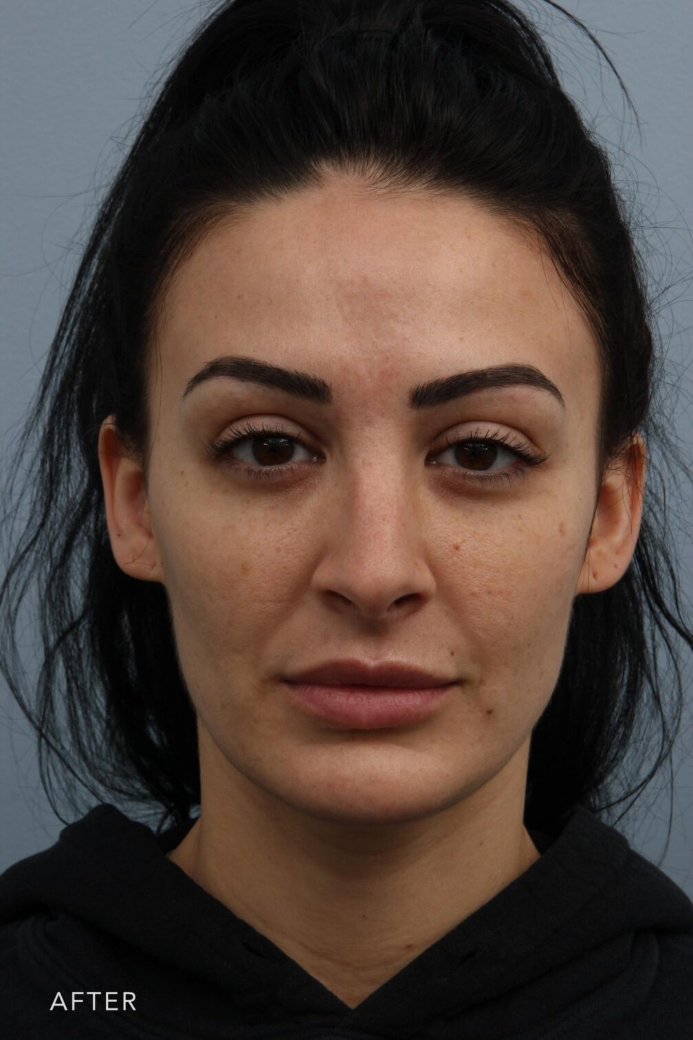 Rhinoplasty & Nasal Reconstruction Gallery | The Williams Center ...