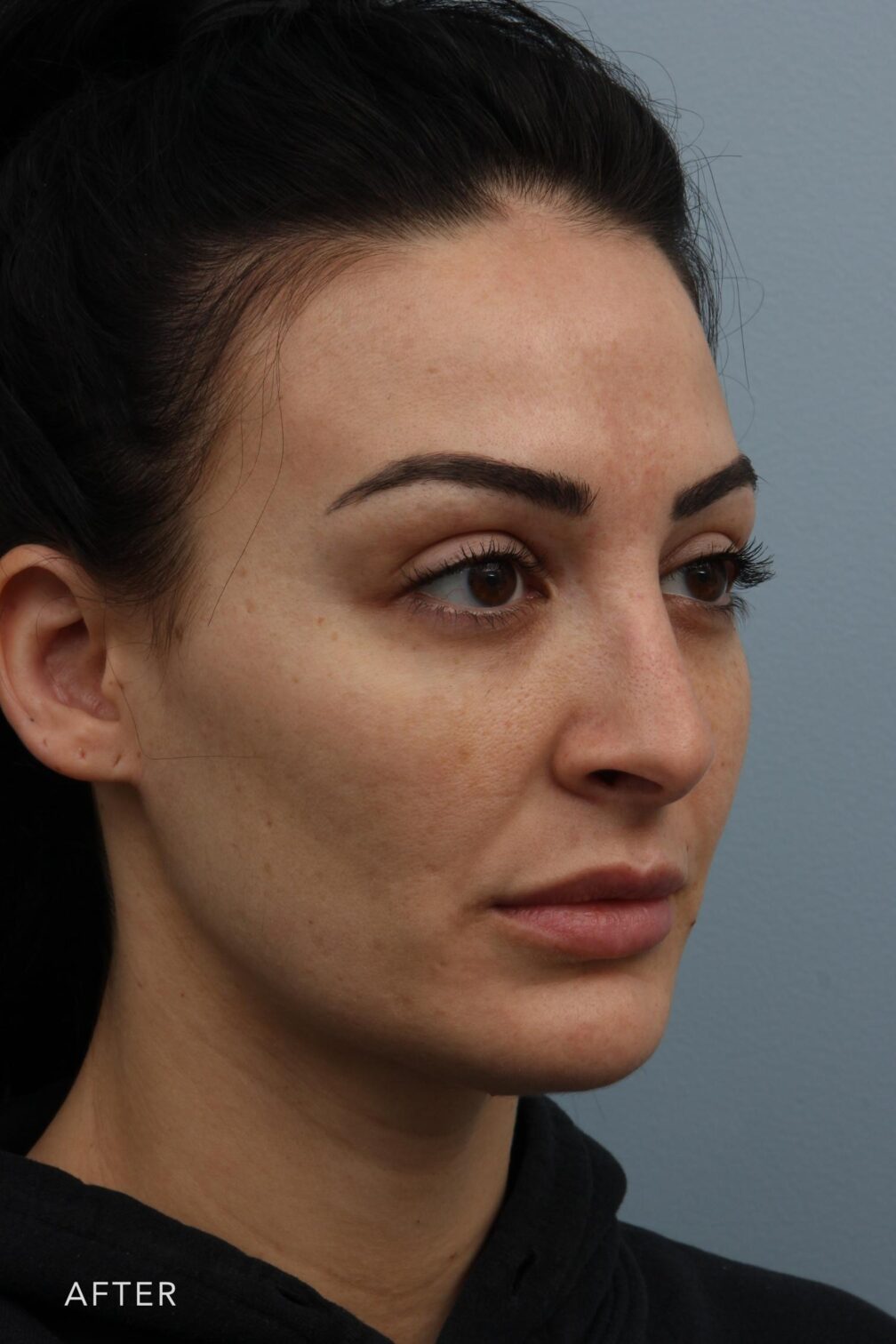 Rhinoplasty & Nasal Reconstruction Gallery | The Williams Center ...