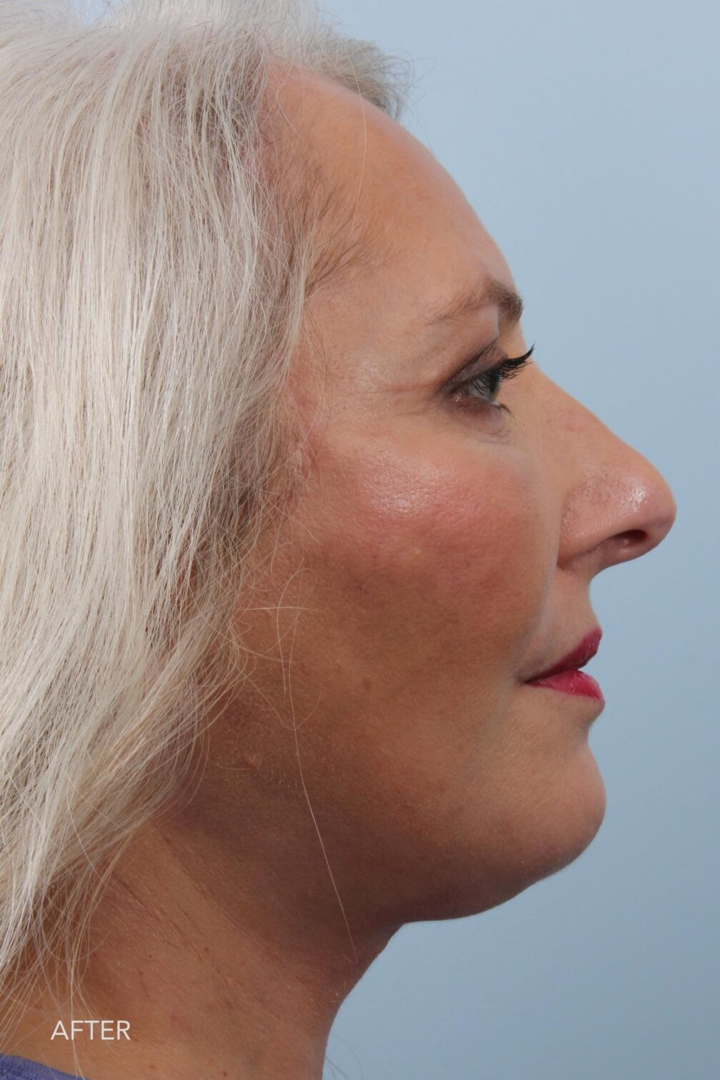 Buccal Fat Removal Pictures - Cheek Surgery | Williams Center Williams ...