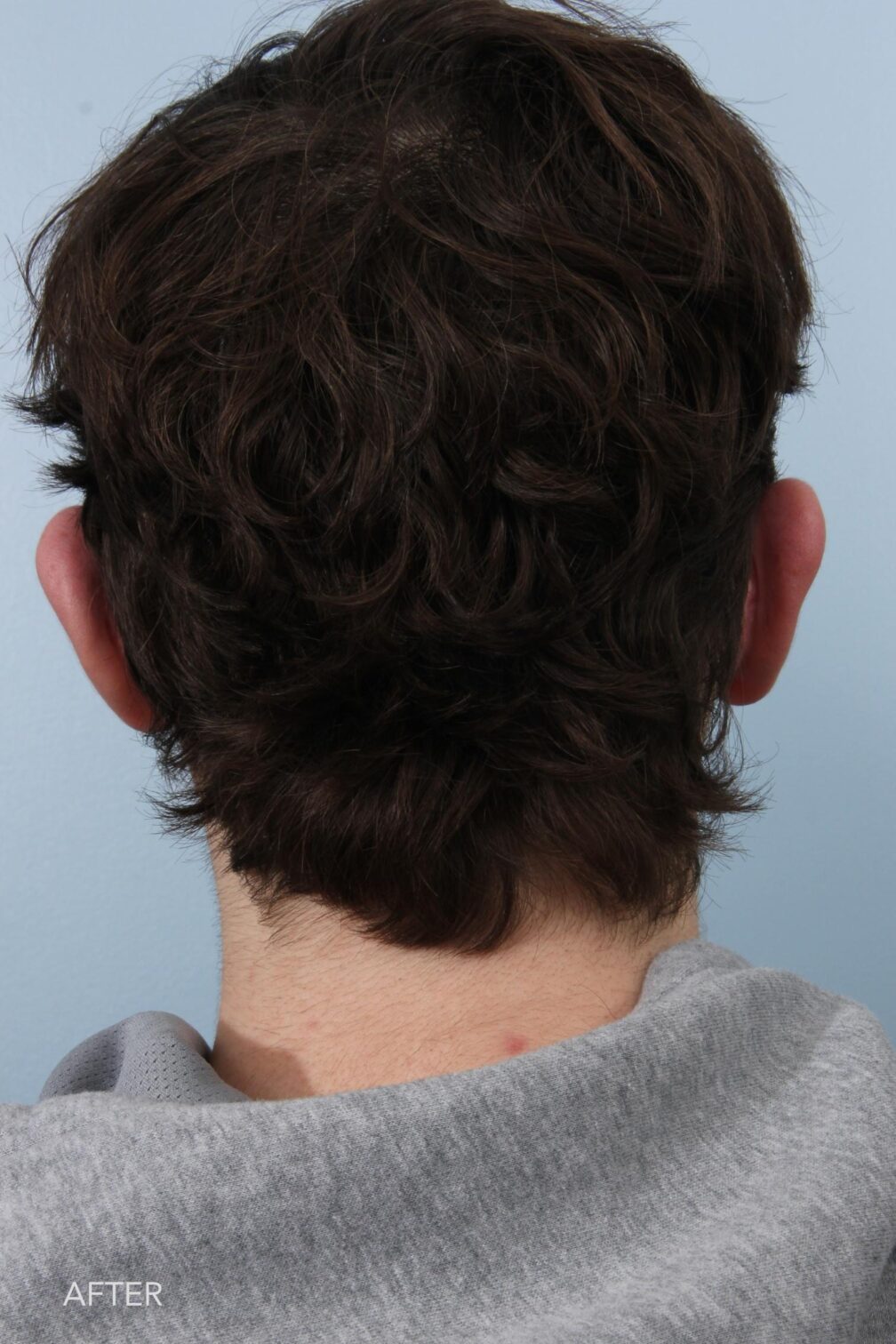 Otoplasty Gallery | The Williams Center Williams Center