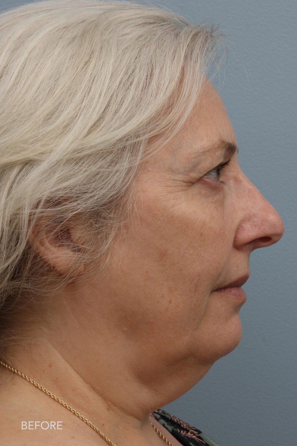 Buccal Fat Removal Pictures - Cheek Surgery | Williams Center Williams ...