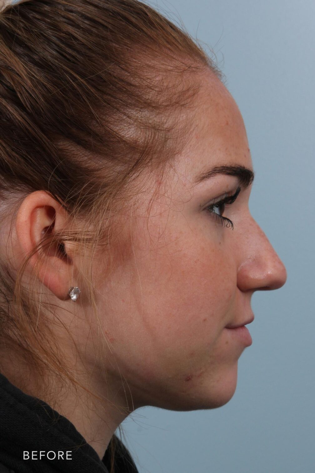 Rhinoplasty & Nasal Reconstruction Pictures | Williams Center Williams ...