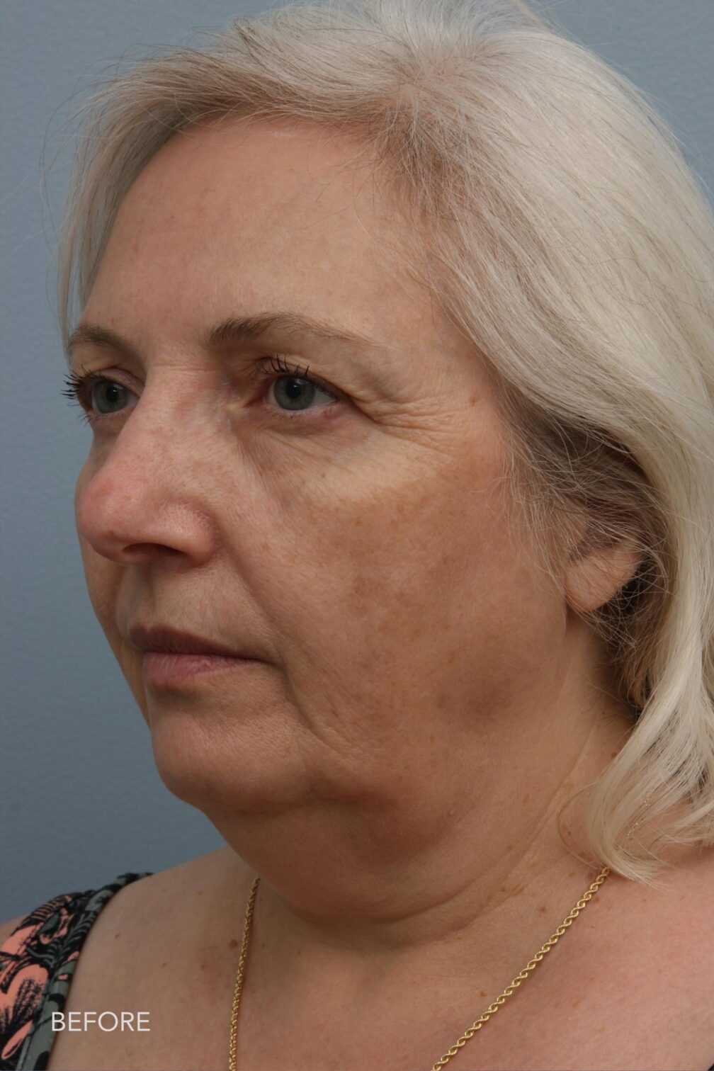 Buccal Fat Removal Pictures - Cheek Surgery | Williams Center Williams ...