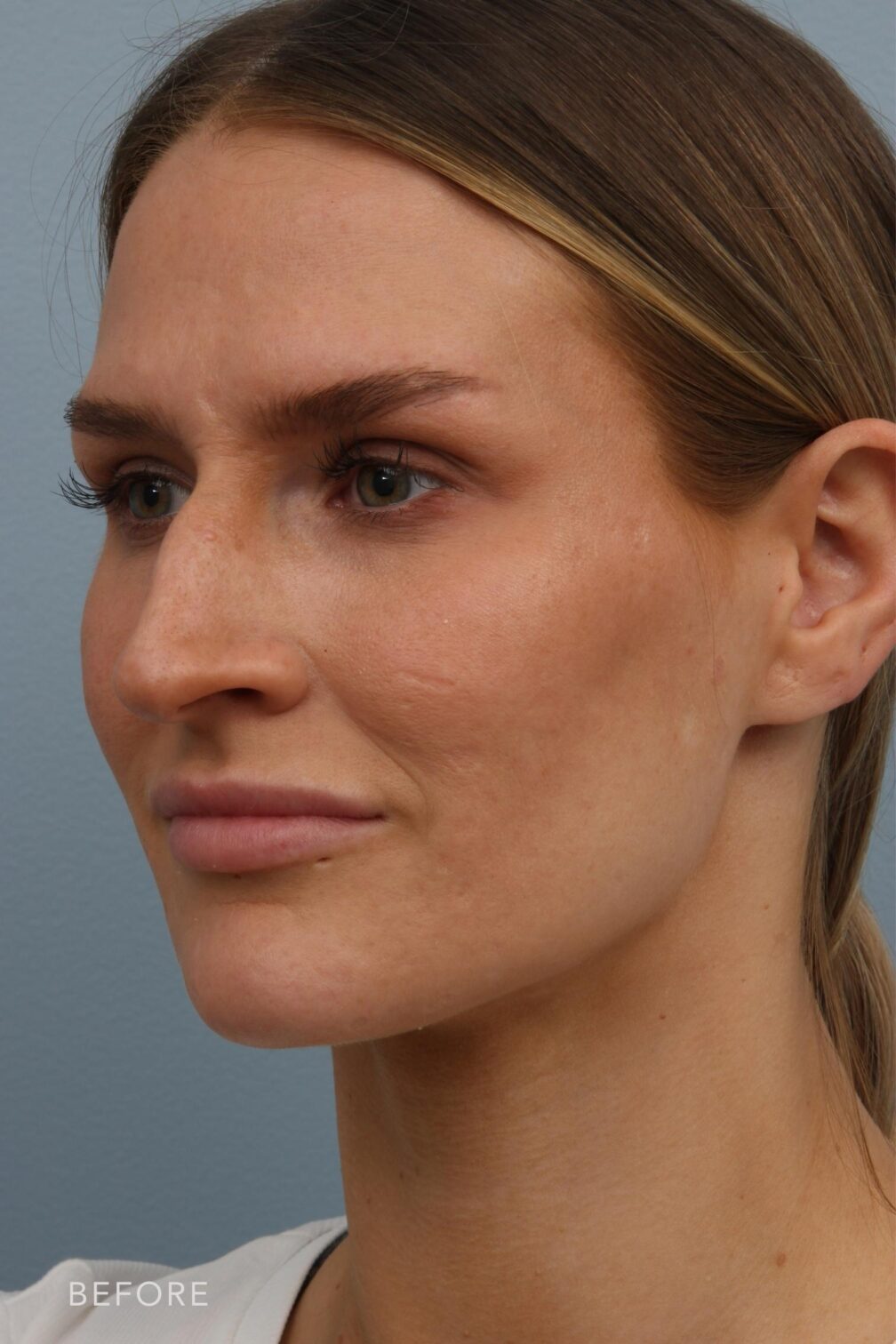 Rhinoplasty & Nasal Reconstruction Pictures | Williams Center Williams ...