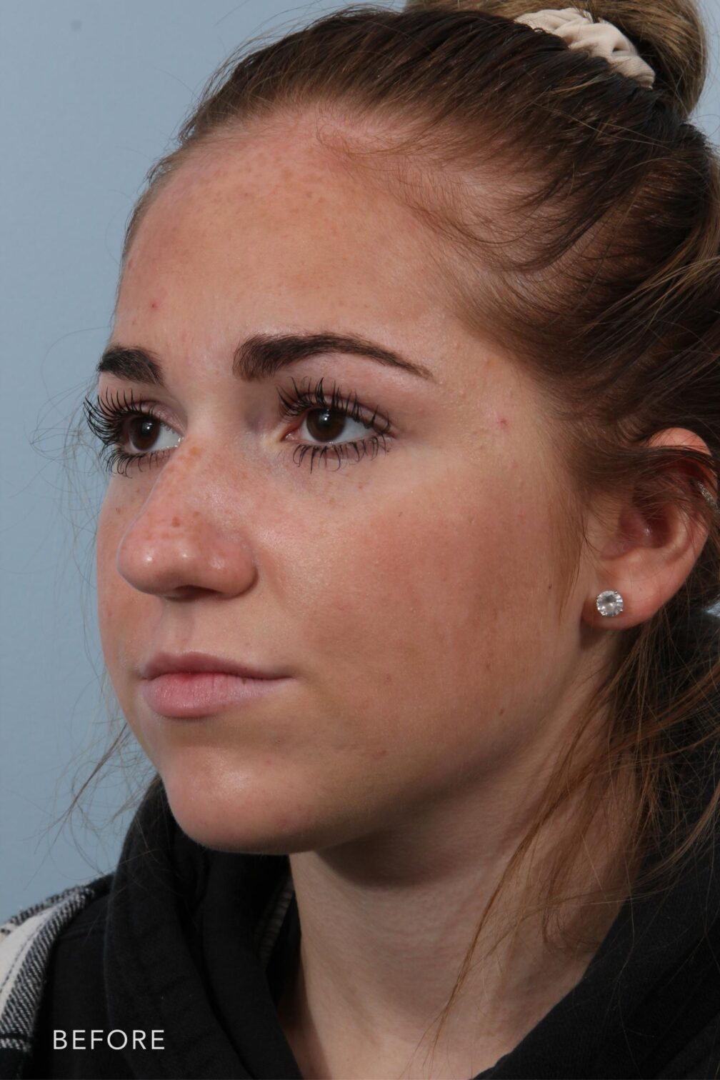 Rhinoplasty & Nasal Reconstruction Pictures | Williams Center Williams ...