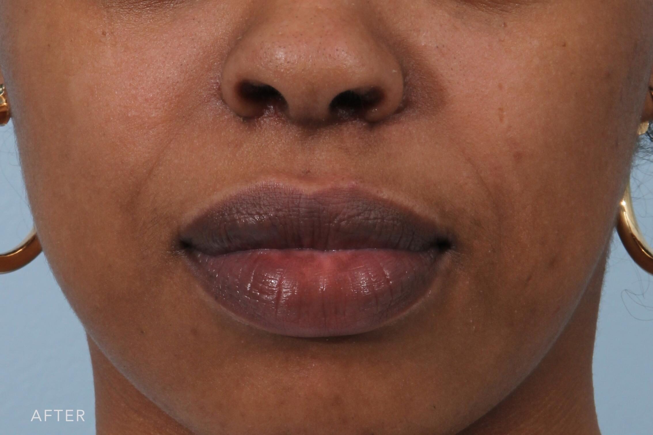 Rhinoplasty & Nasal Reconstruction Pictures | Williams Center Williams ...