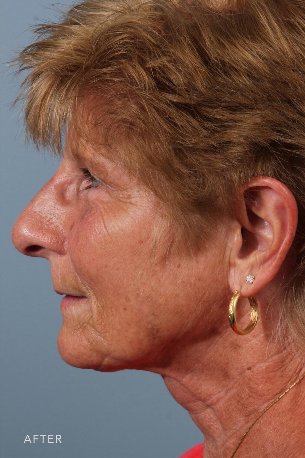 Blepharoplasty Pictures - Eyelid Surgery | Williams Center Williams Center
