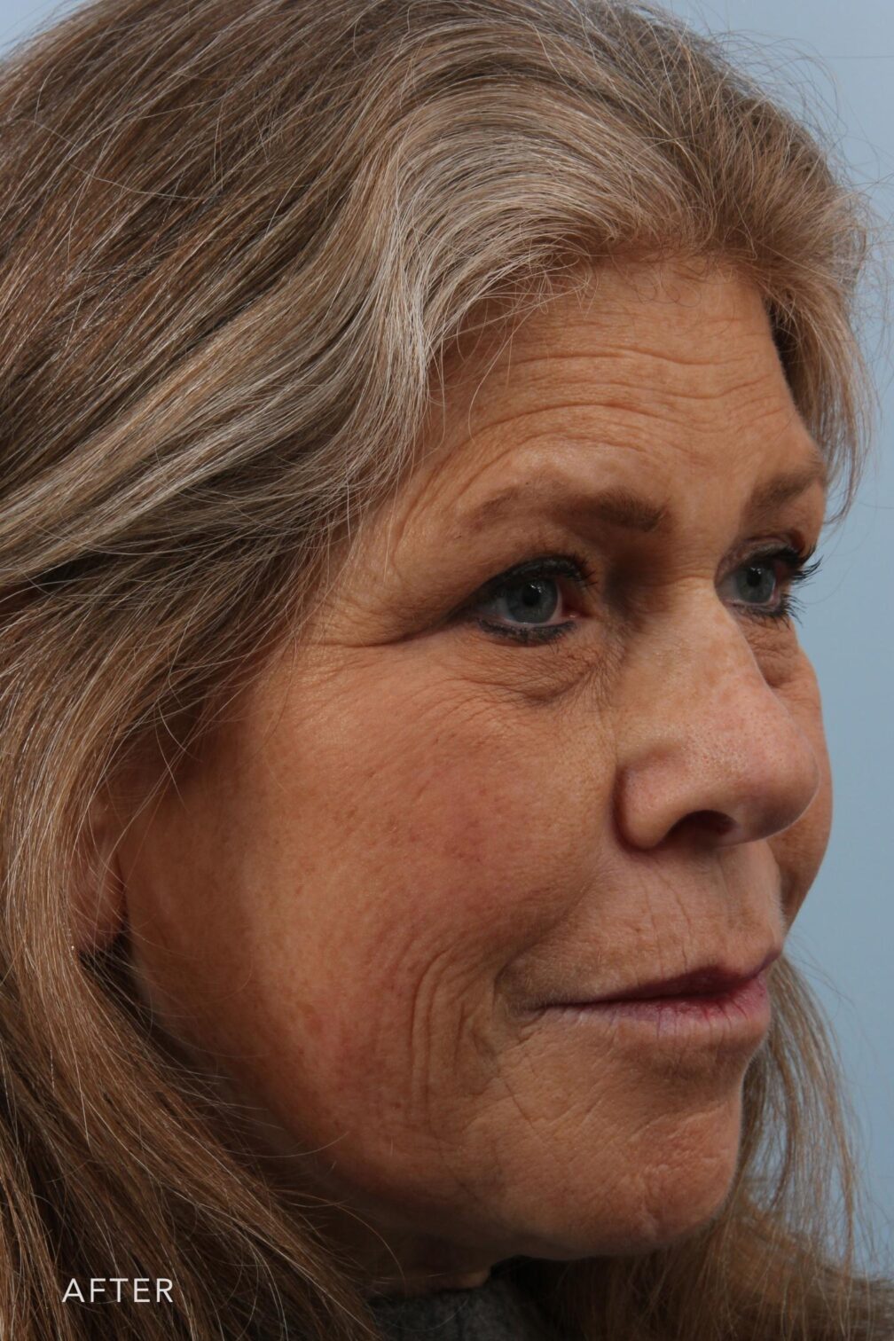 Rhinoplasty & Nasal Reconstruction Pictures | Williams Center Williams ...