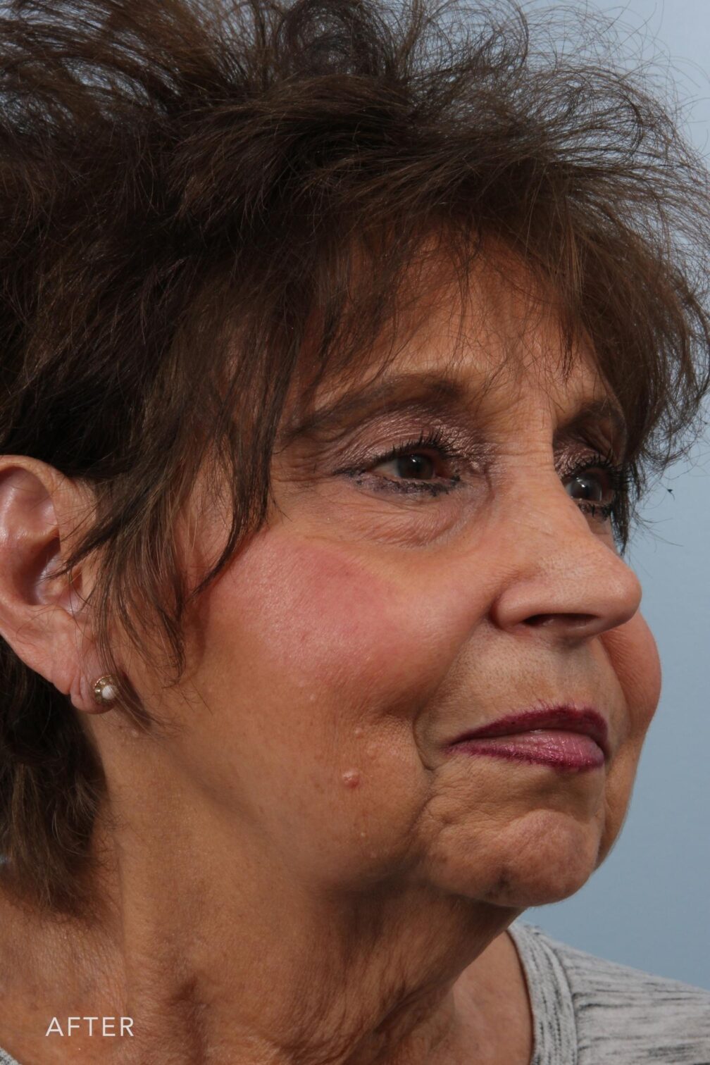 Blepharoplasty Pictures - Eyelid Surgery | Williams Center Williams Center