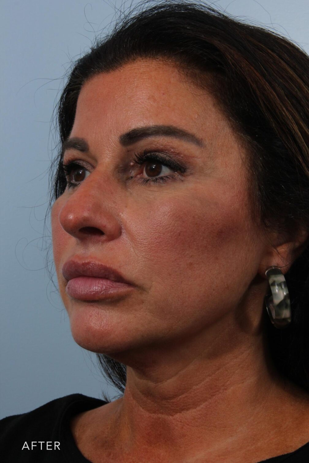 Blepharoplasty Pictures - Eyelid Surgery | Williams Center Williams Center