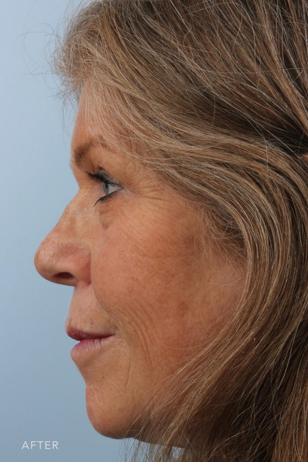 Rhinoplasty & Nasal Reconstruction Pictures | Williams Center Williams ...