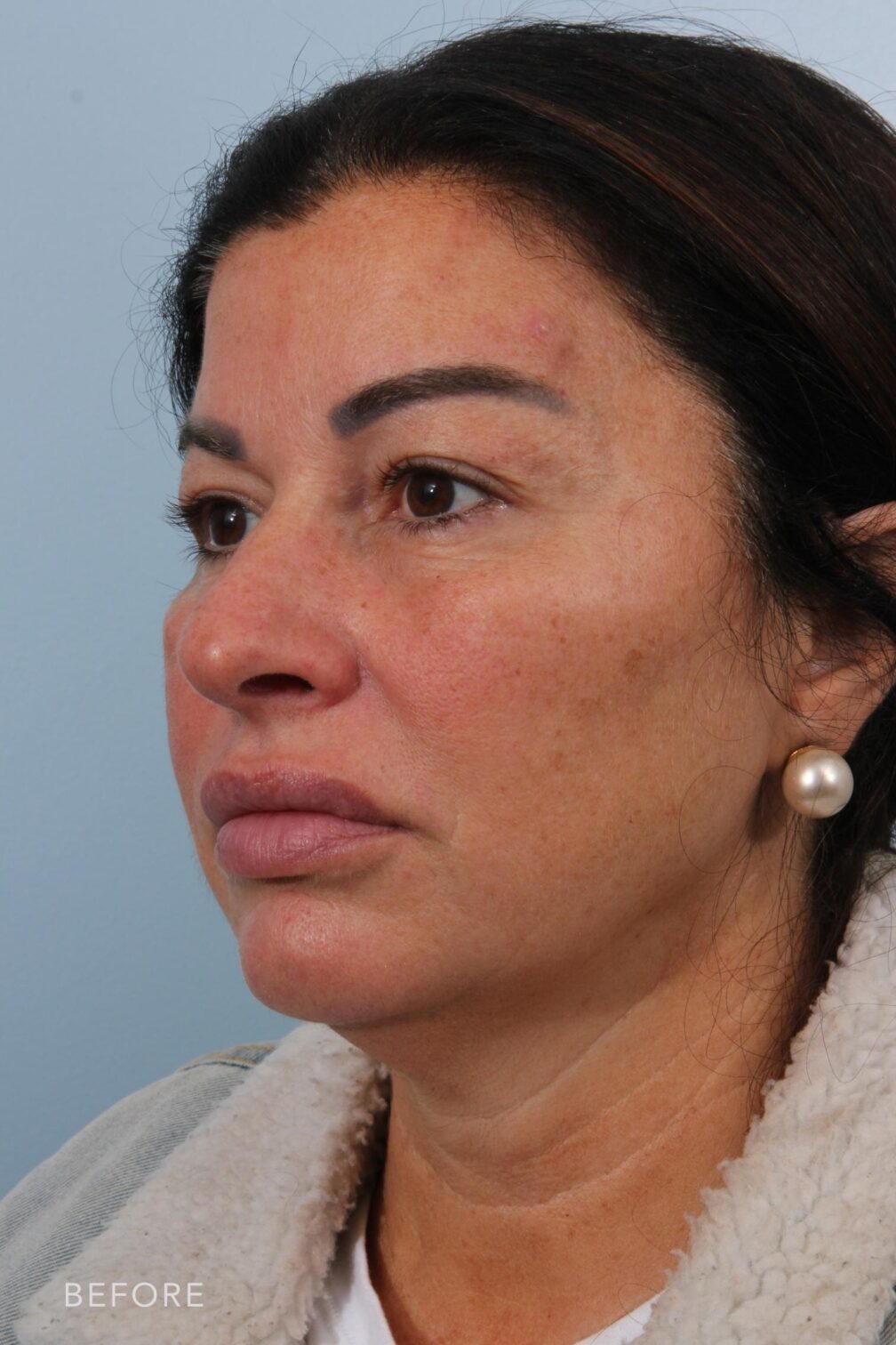 Blepharoplasty Pictures - Eyelid Surgery | Williams Center Williams Center