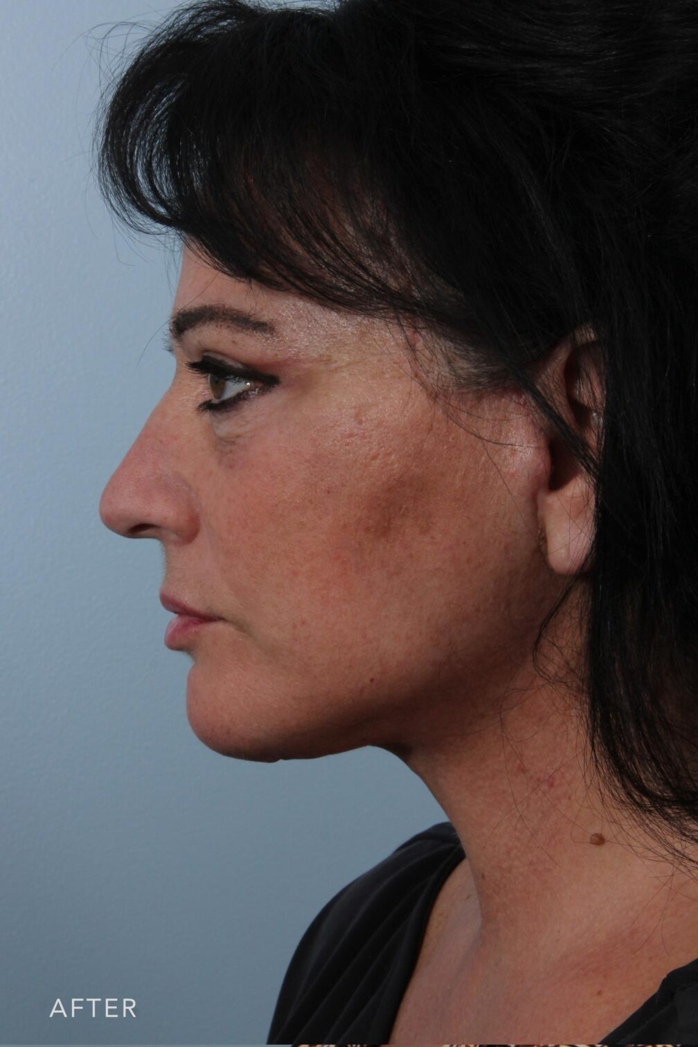 Blepharoplasty Gallery | The Williams Center Williams Center