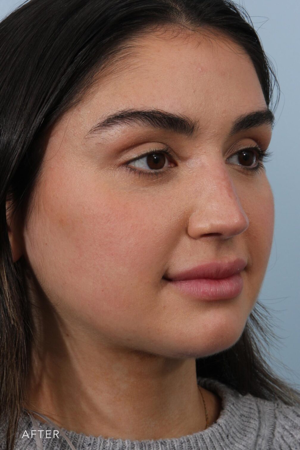 Rhinoplasty & Nasal Reconstruction Pictures | Williams Center Williams ...